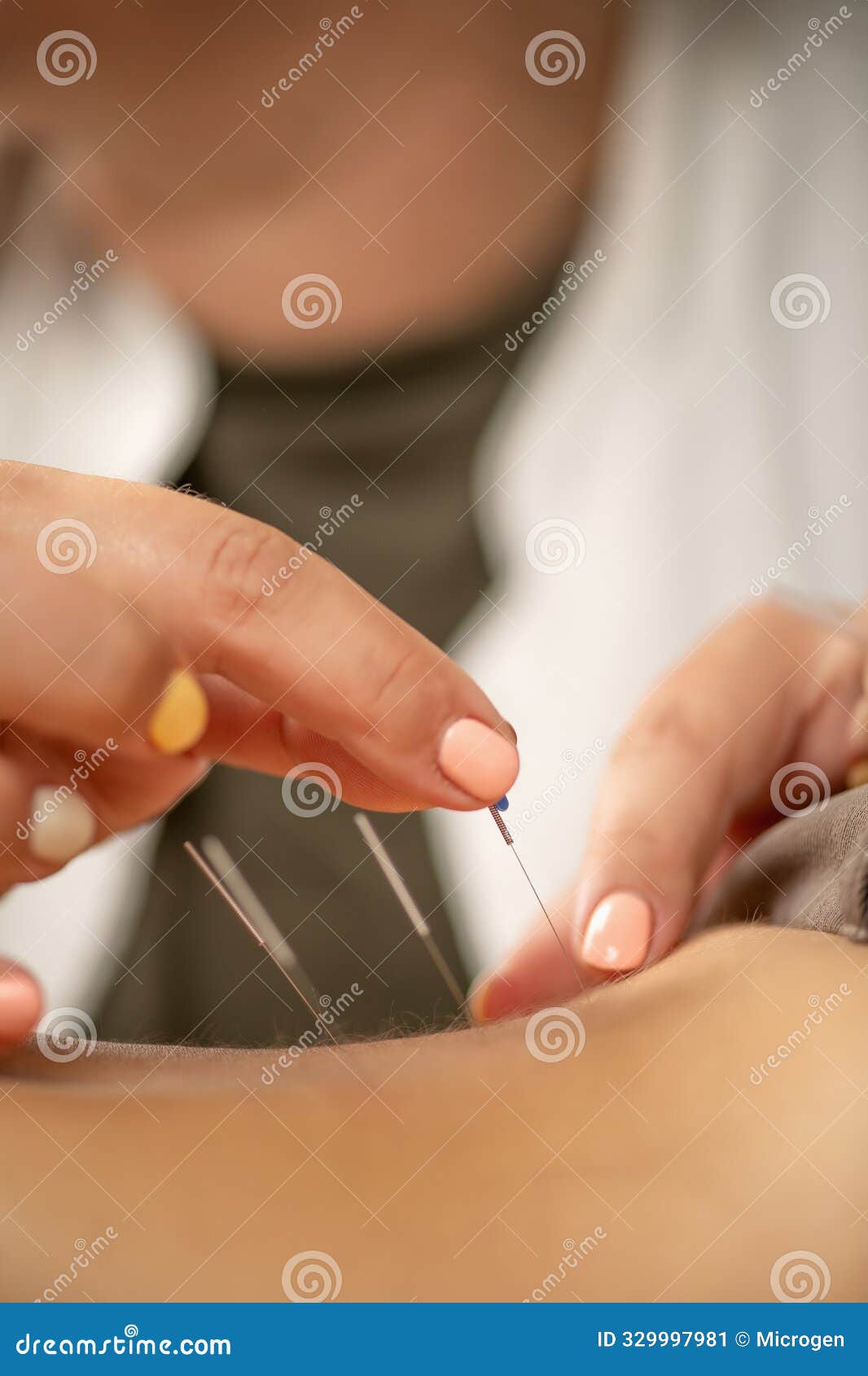 Acupuncture for Lower Back Pain Stock Image - Image of needling, back ...