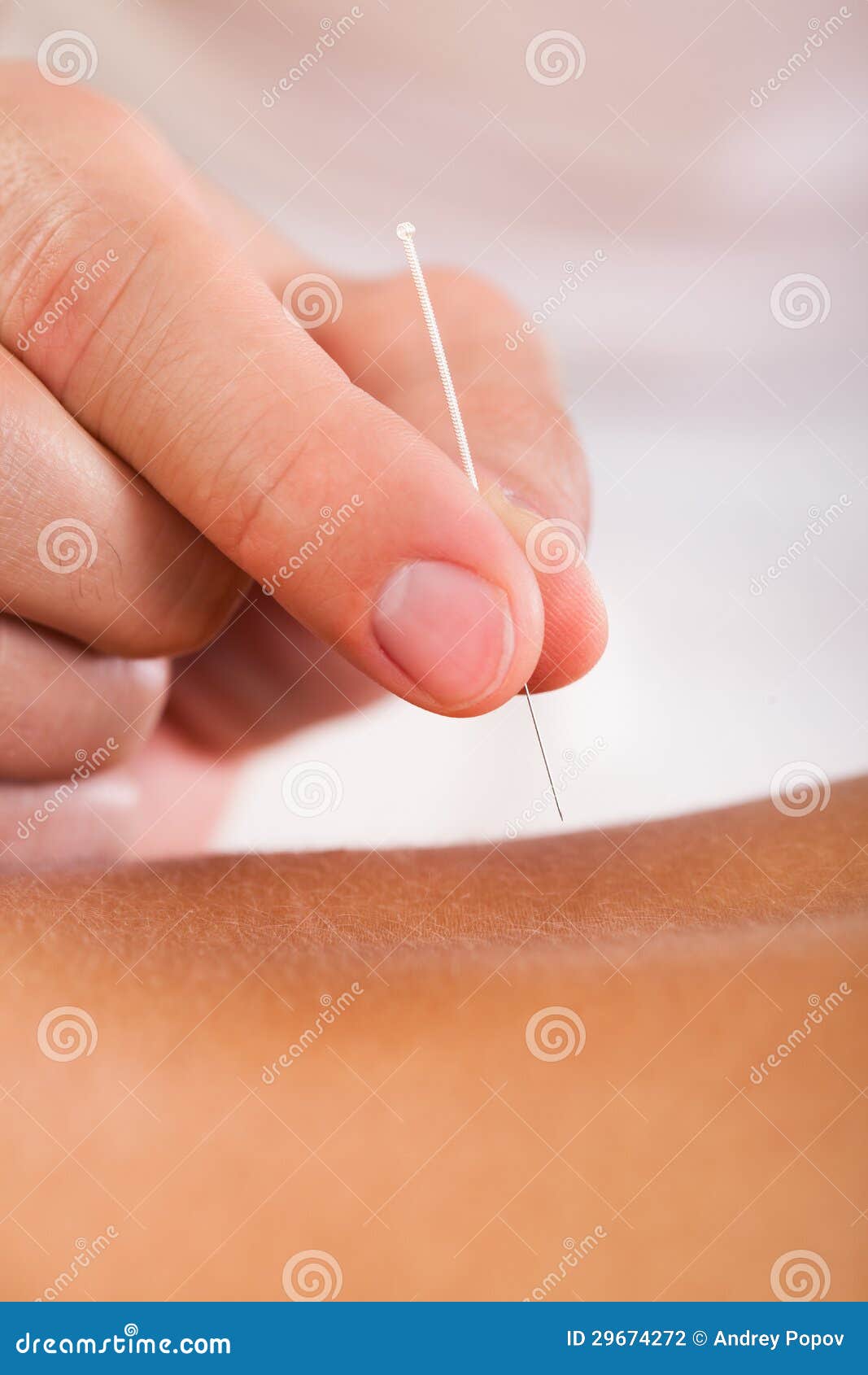 Acupuncture Needle Inserted Stock Photo - Image of anesthetize, clinic ...