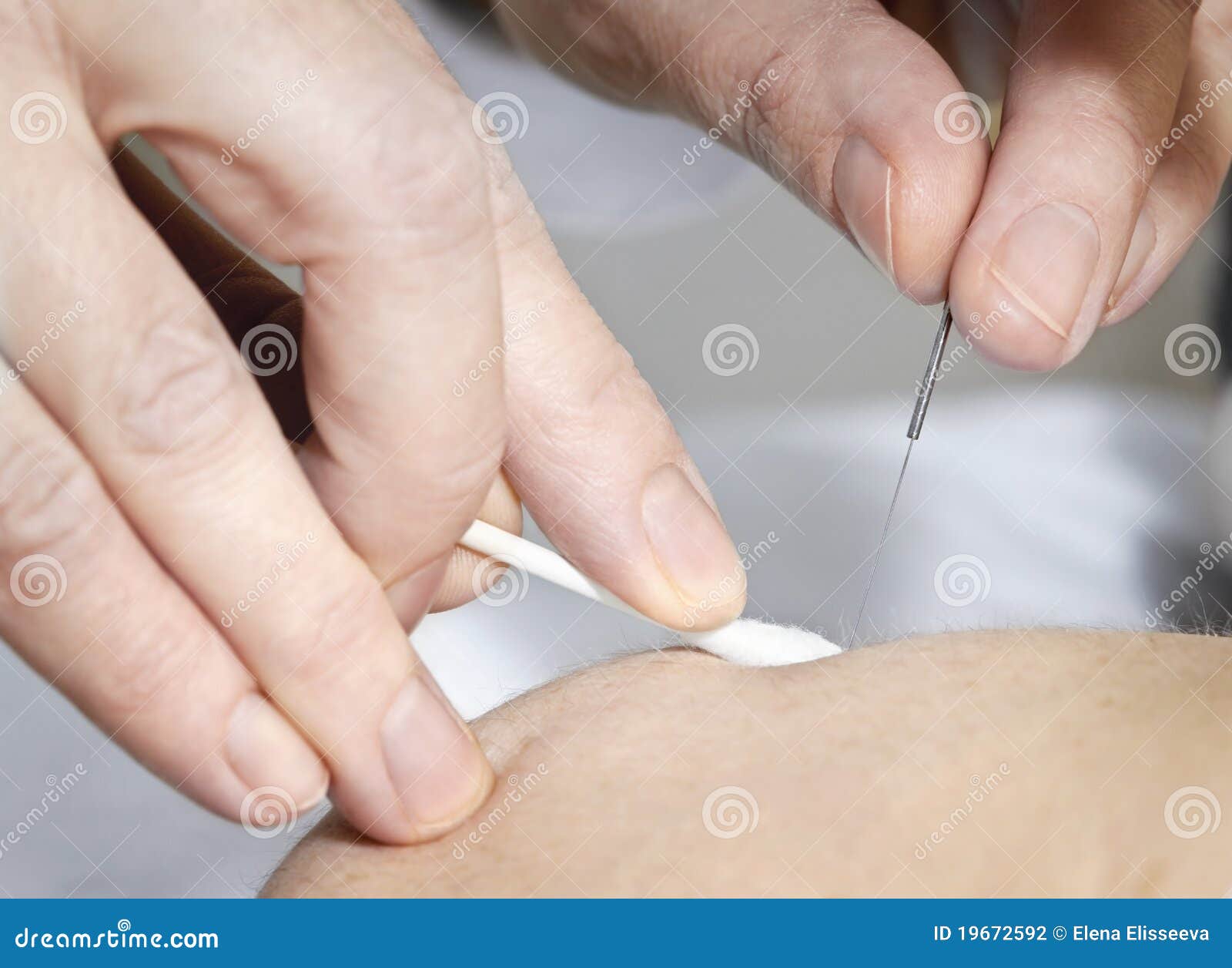 Acupuncture needle in skin stock photo. Image of manipulated - 19672592