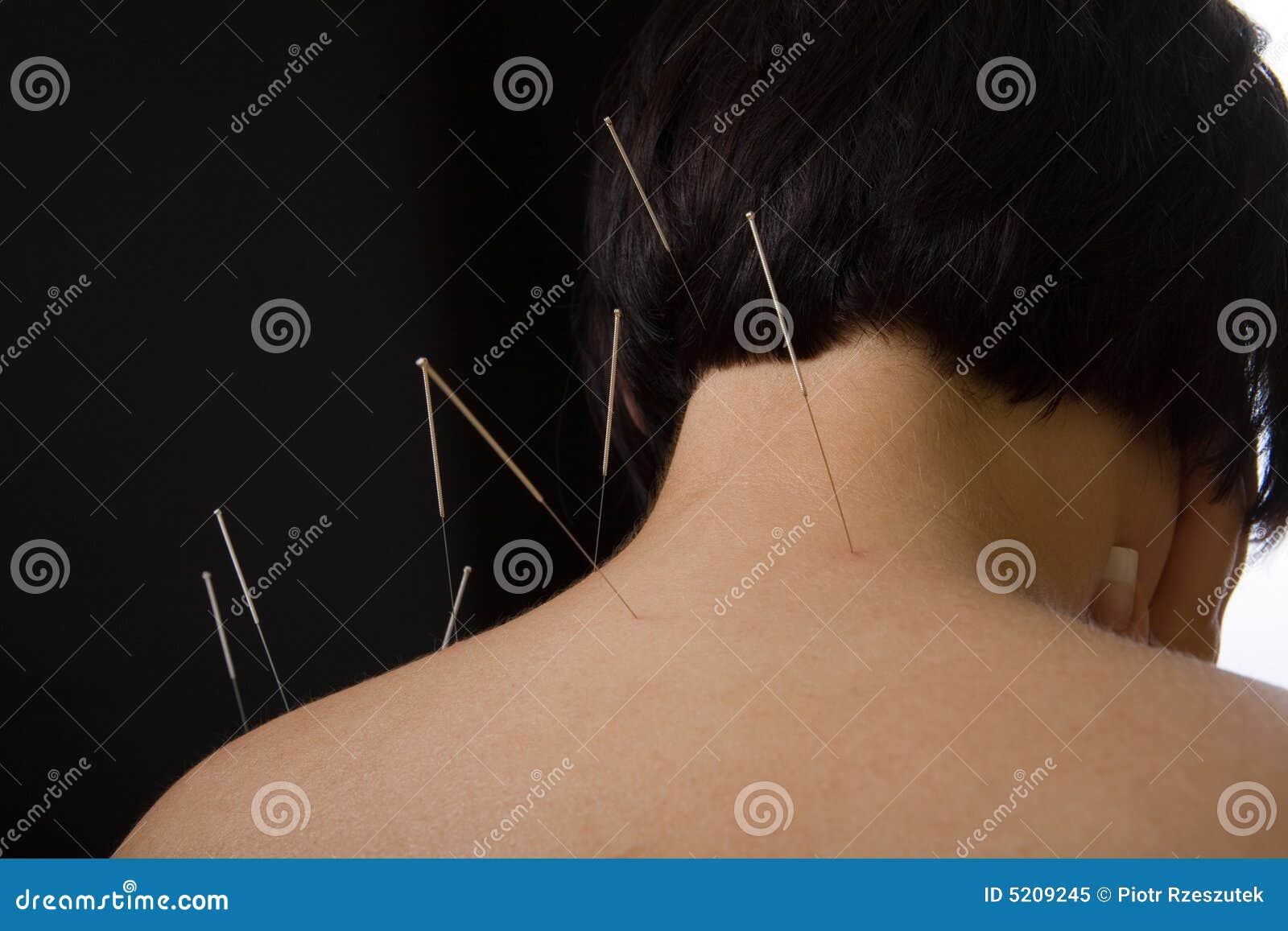 Acupuncture Needles on Back of a Young Woman Stock Image - Image of ...