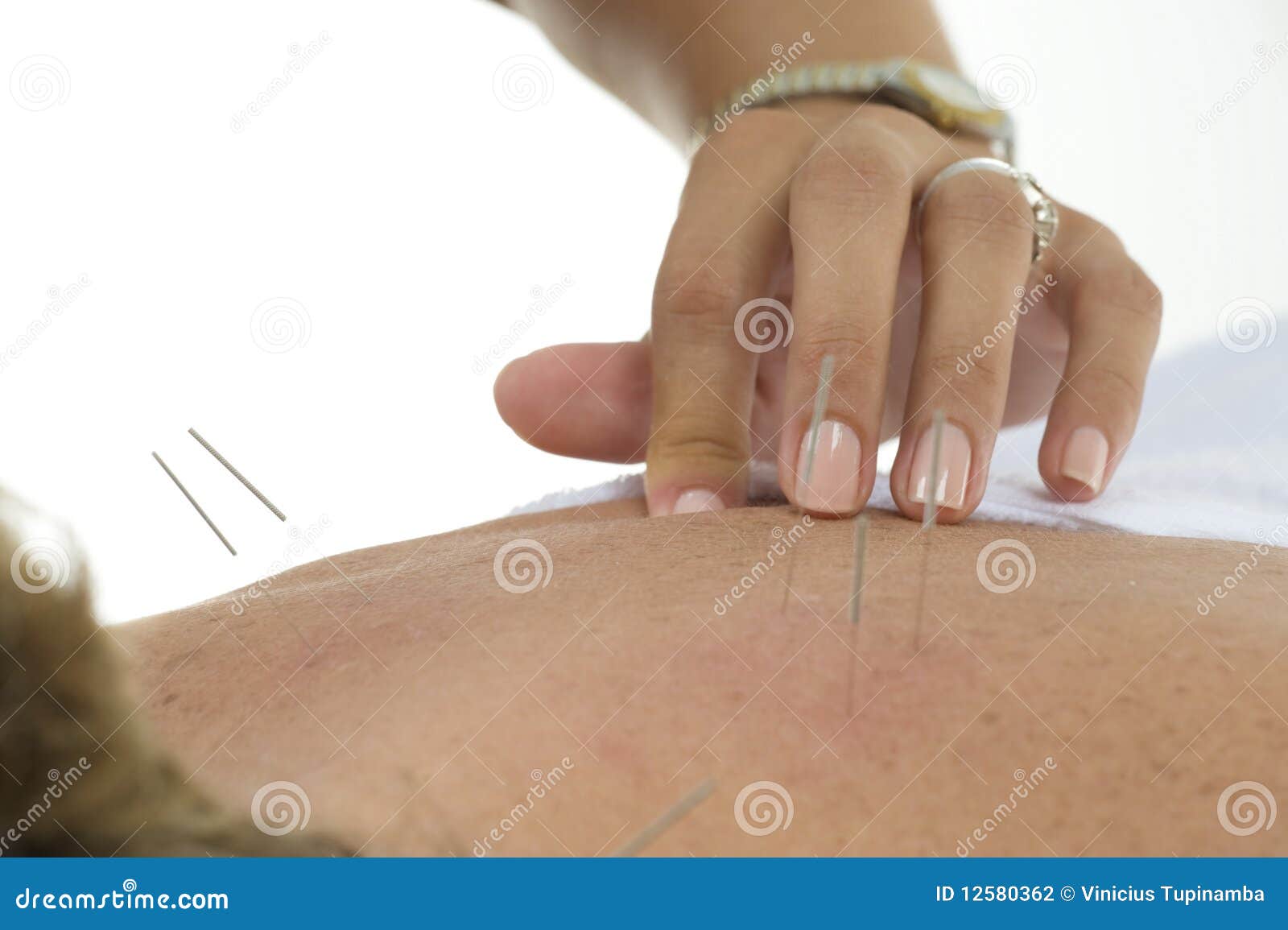 Acupuncture Needles in Backs Stock Photo - Image of lifestyle, close ...