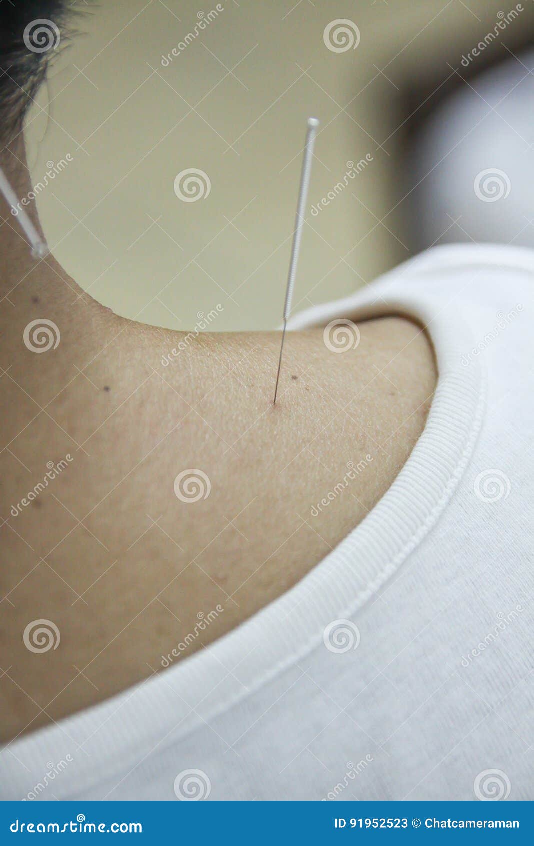Acupuncture stock image. Image of chinese, physiotherapy - 91952523