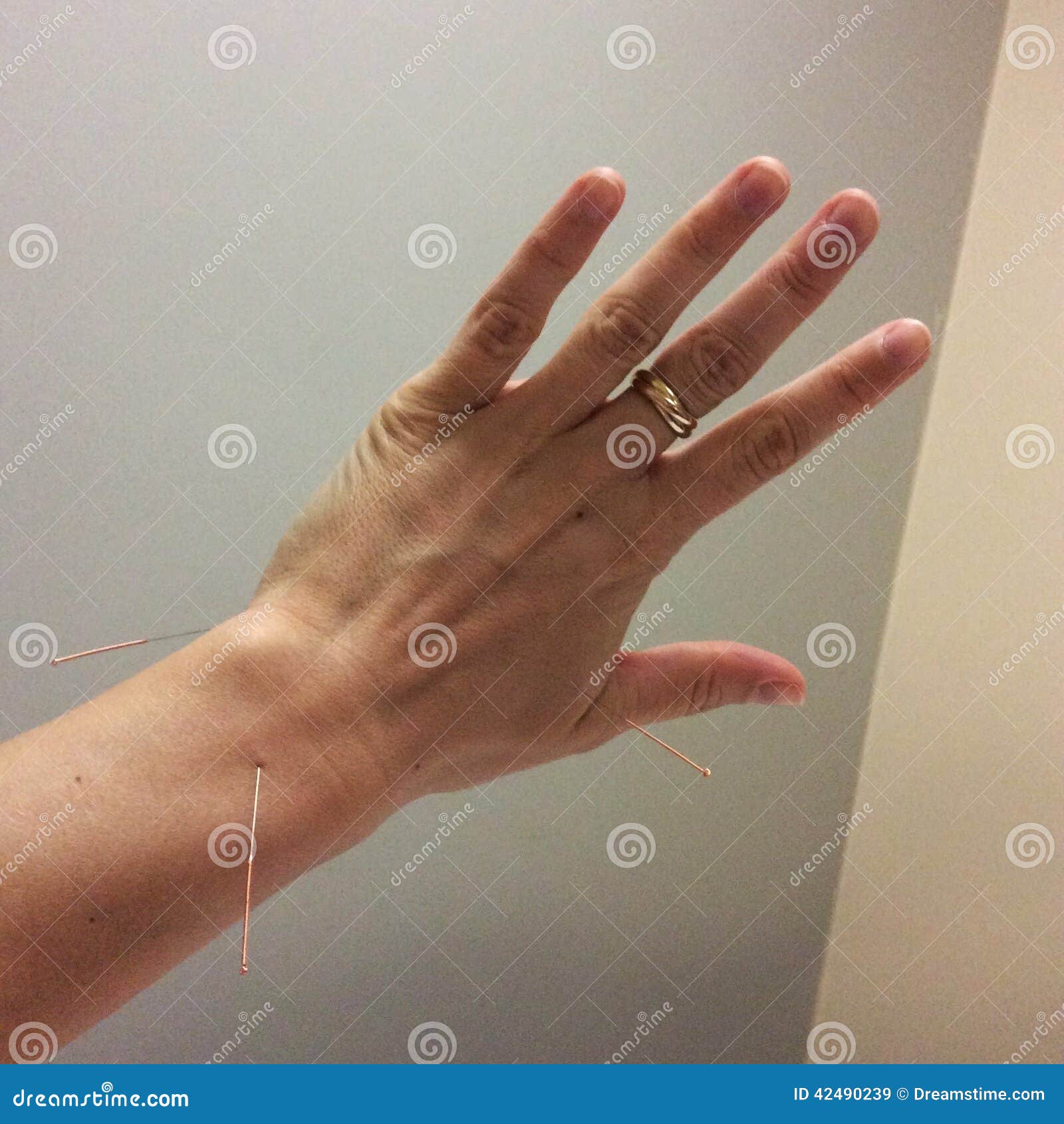 Acupuncture session stock image. Image of needles, holistic - 42490239