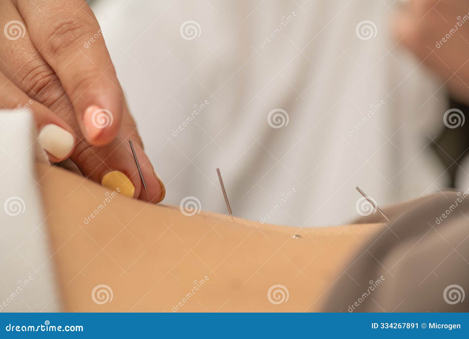 Acupuncture Session for Stress and Anxiety Stock Image - Image of skin ...