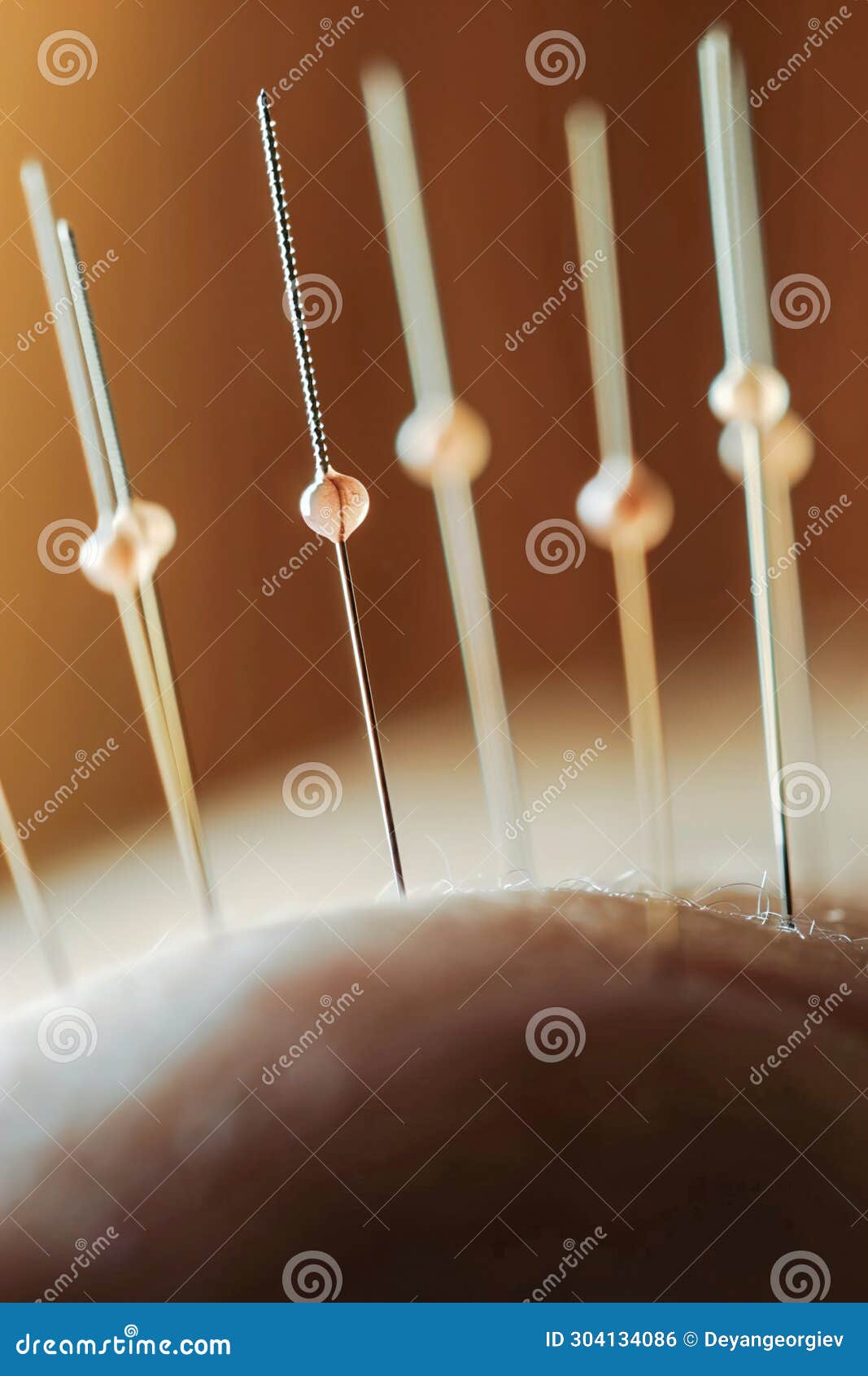 Acupuncture Sessions with Close-ups of the Process on the Head Stock ...