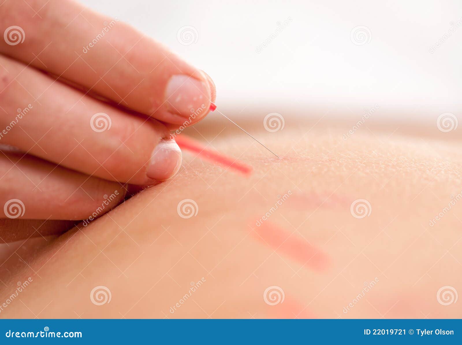 Acupuncture Stimulation Macro Stock Image - Image of natural, bladder ...