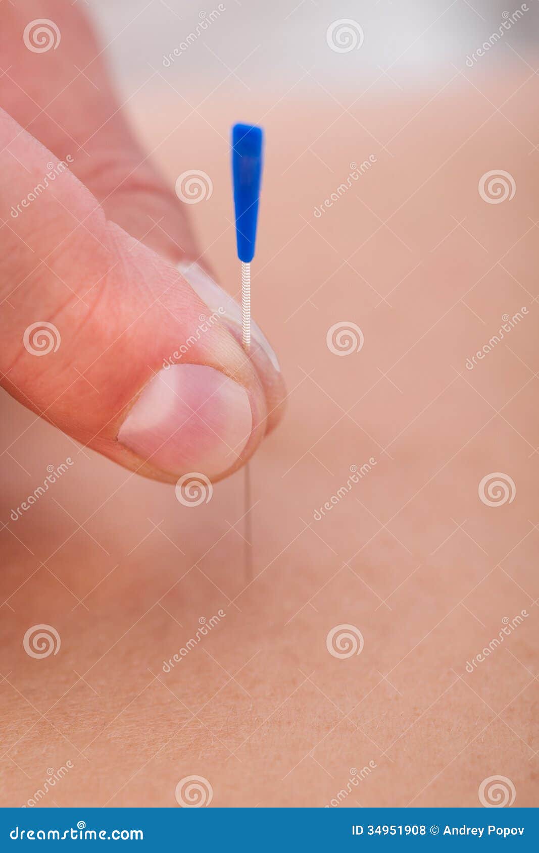 An Acupuncture Therapy in a Spa Center Stock Photo - Image of insert ...