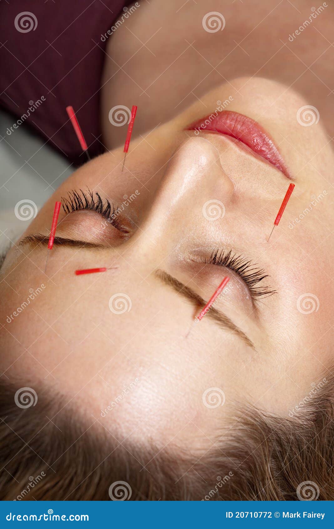 Acupuncture Treatment To Face Stock Photo - Image of vertical, facial ...