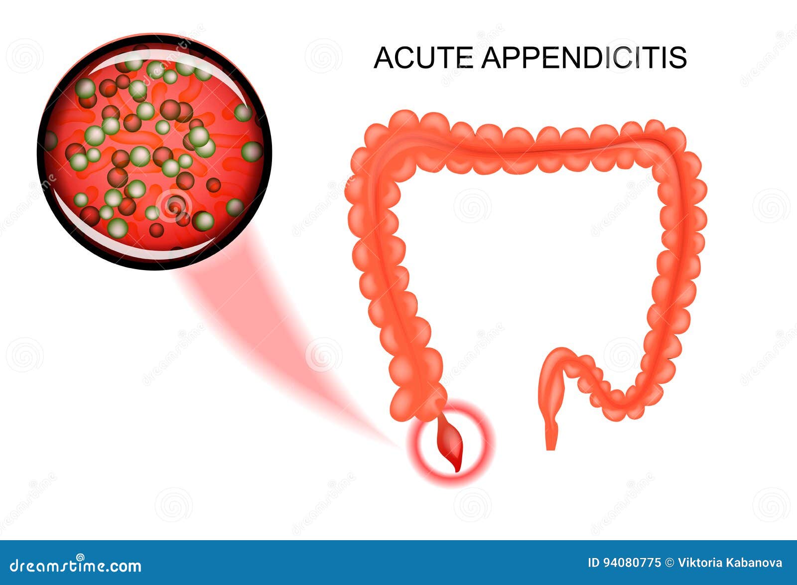 Acute Appendicitis Bacteria Stock Vector Illustration Of Medicine