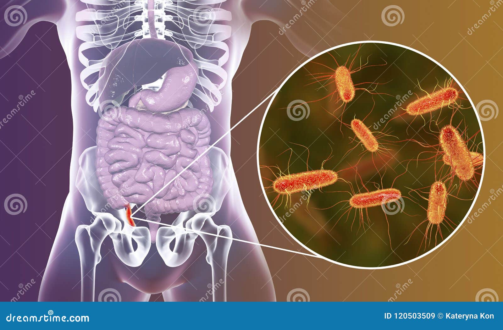 Acute Appendicitis Illustration Stock Illustration Illustration Of