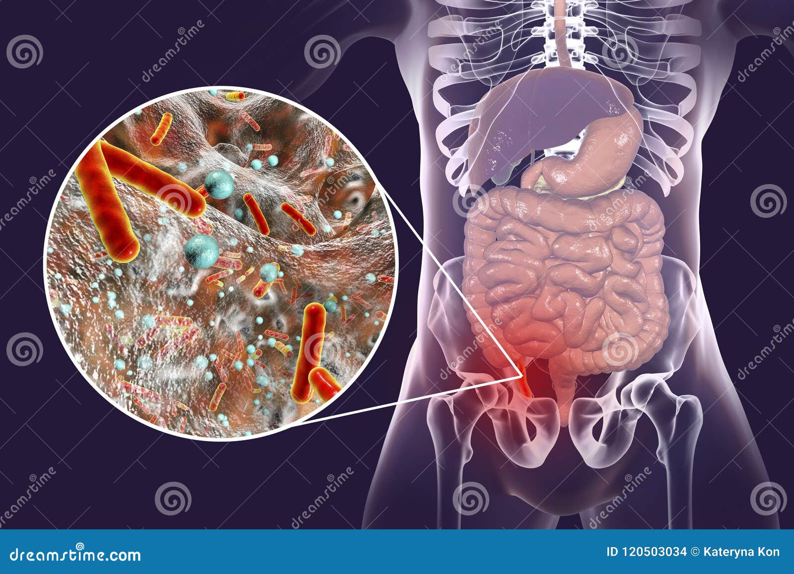 Acute Appendicitis Illustration 120503034