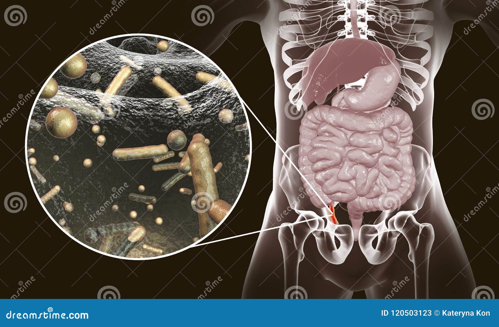 Acute Appendicitis Illustration Stock Illustration Illustration Of