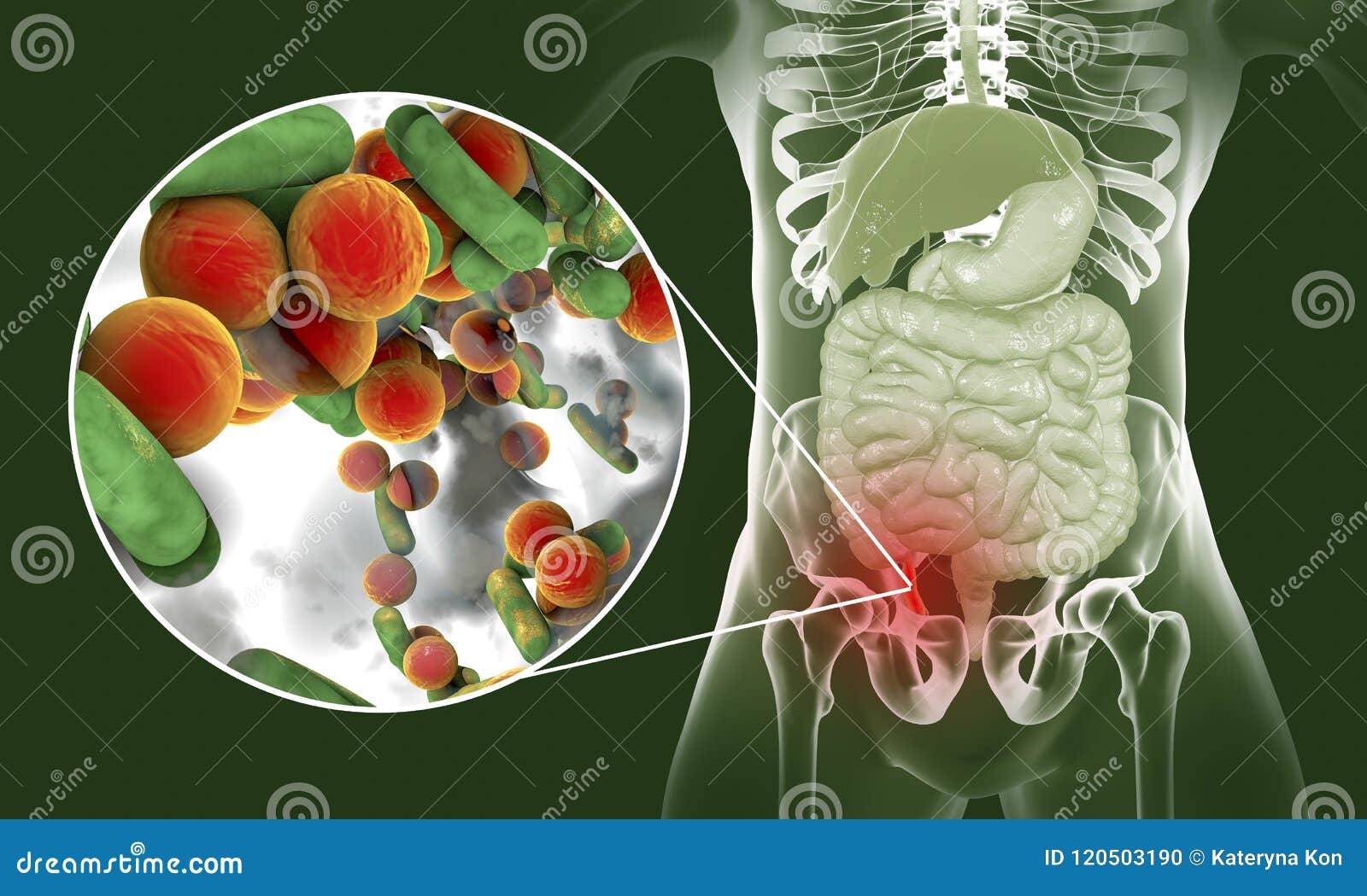 Acute Appendicitis Illustration Stock Illustration Illustration Of