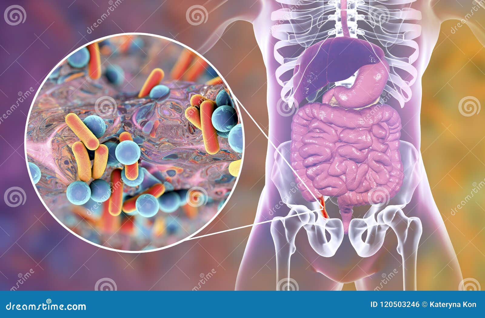 Acute Appendicitis Illustration Stock Illustration Illustration Of