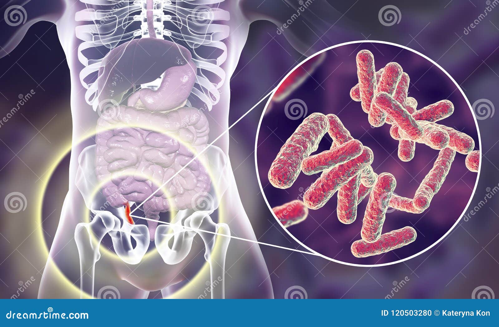Acute Appendicitis Illustration Stock Illustration Illustration Of