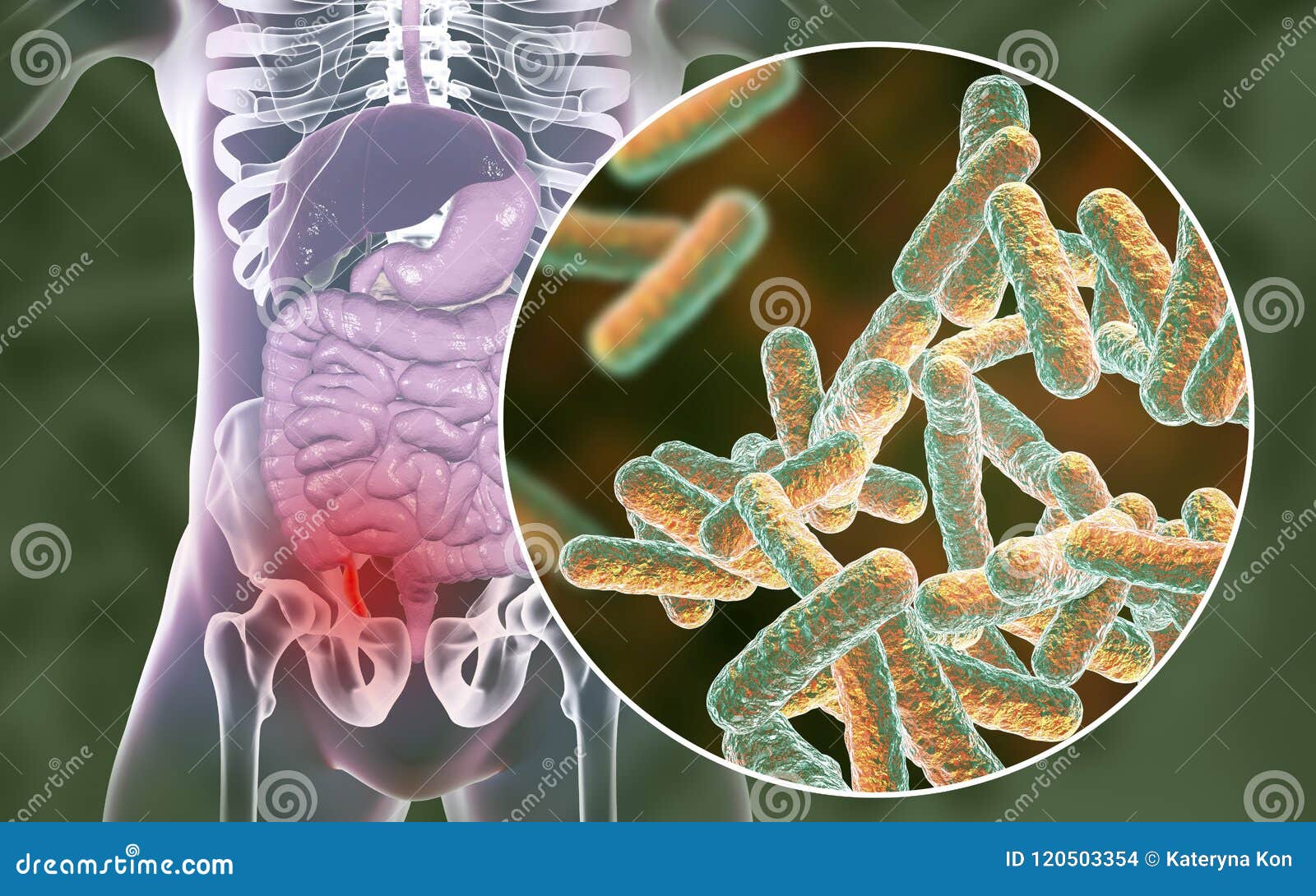 Acute Appendicitis Illustration Stock Illustration Illustration Of