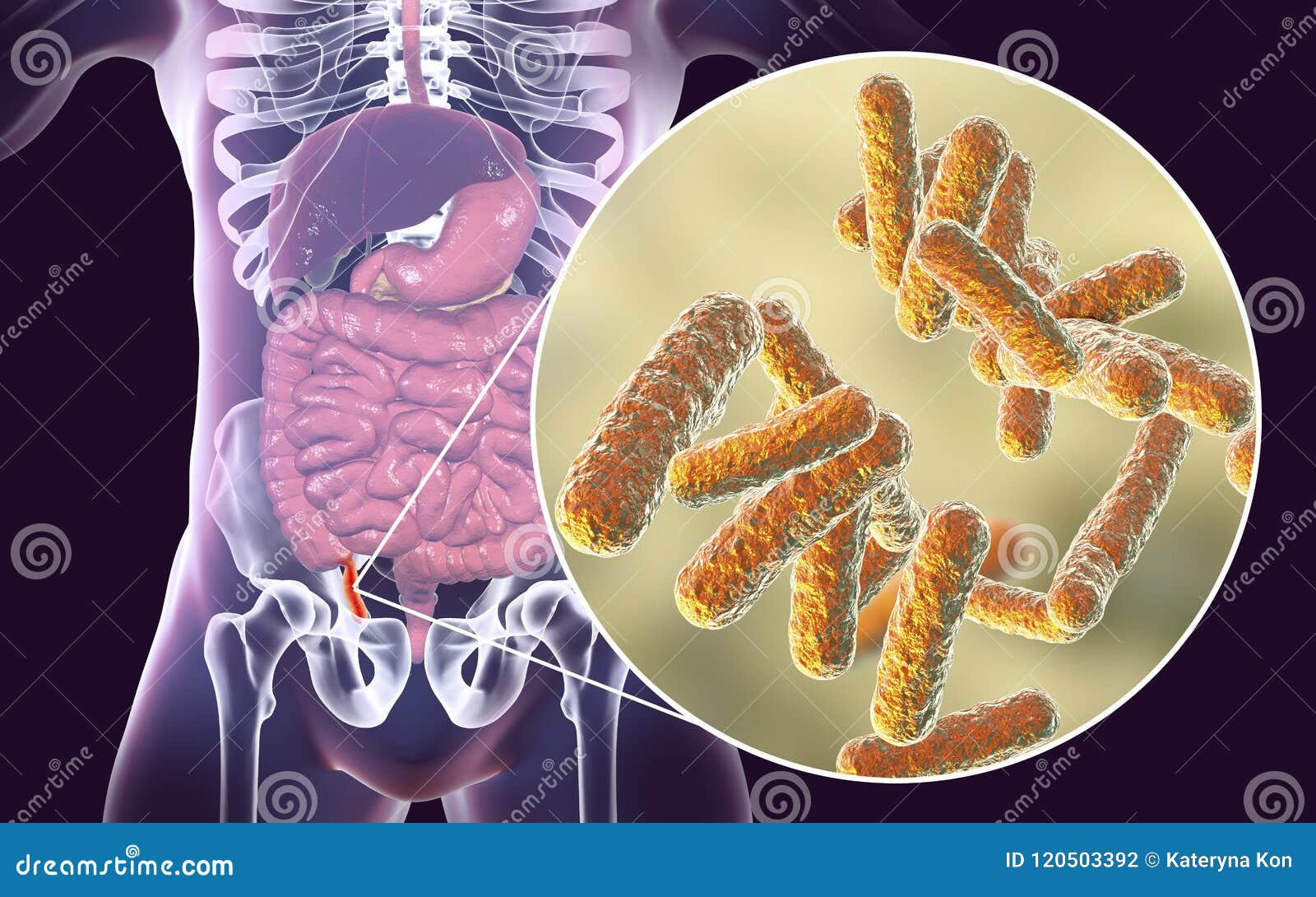 Acute Appendicitis Illustration | CartoonDealer.com #120503392