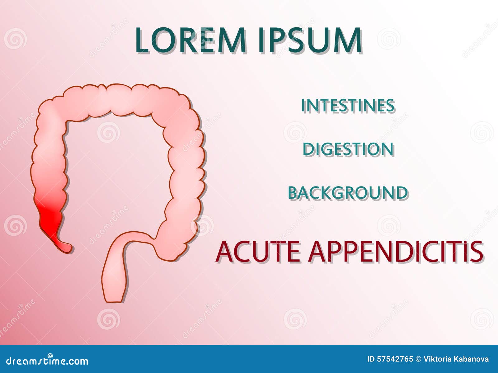 Acute Appendicitis Illustration | CartoonDealer.com #120503508