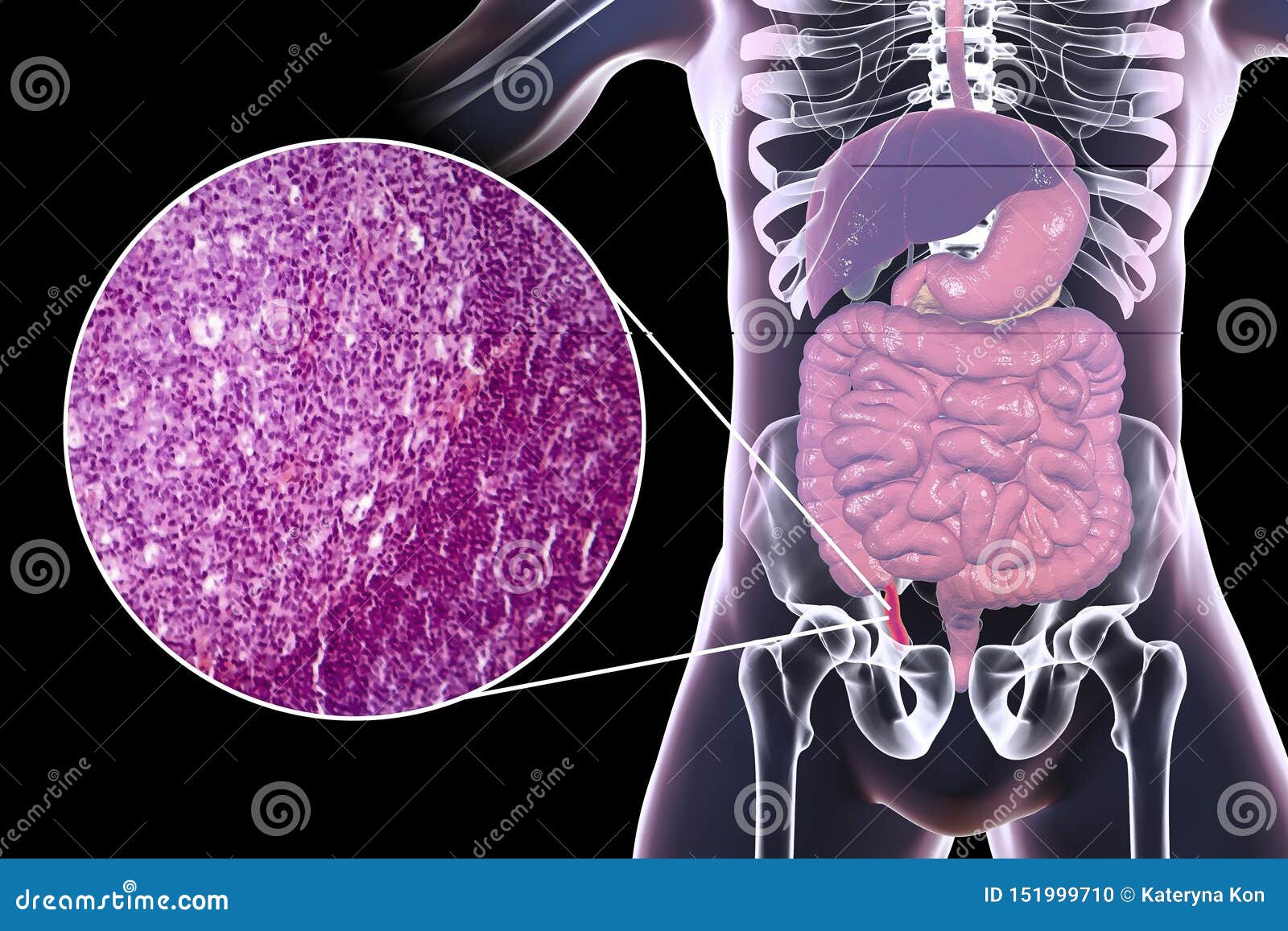 Acute Appendicitis, Illustration and Light Micrograph Stock ...