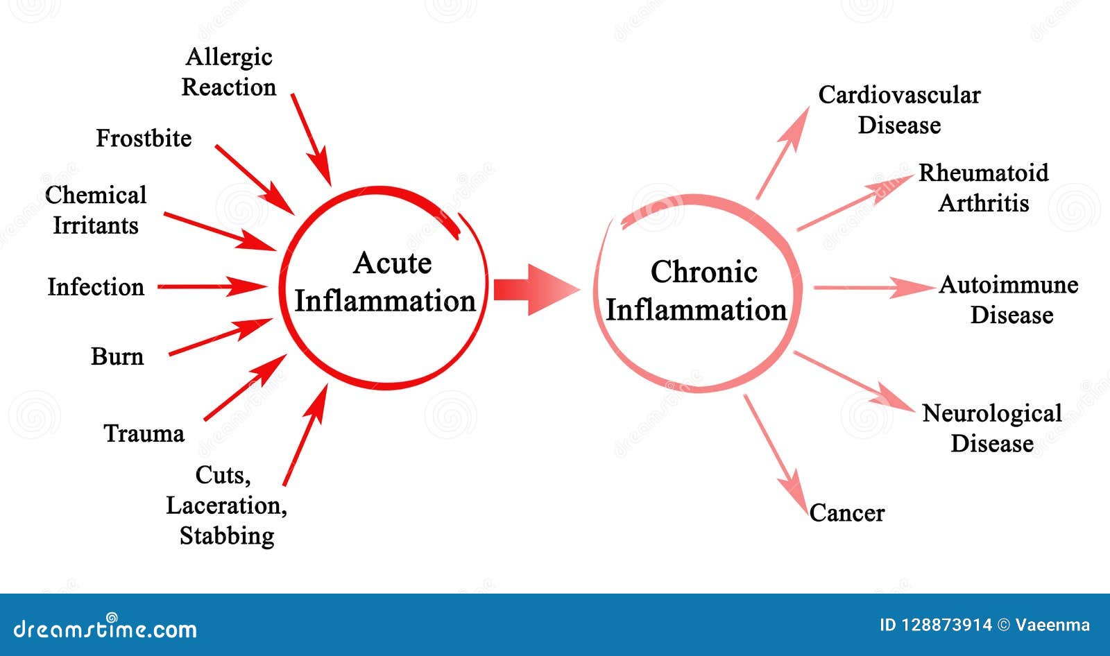 Acute and Chronic Inflammation Stock Illustration - Illustration of ...