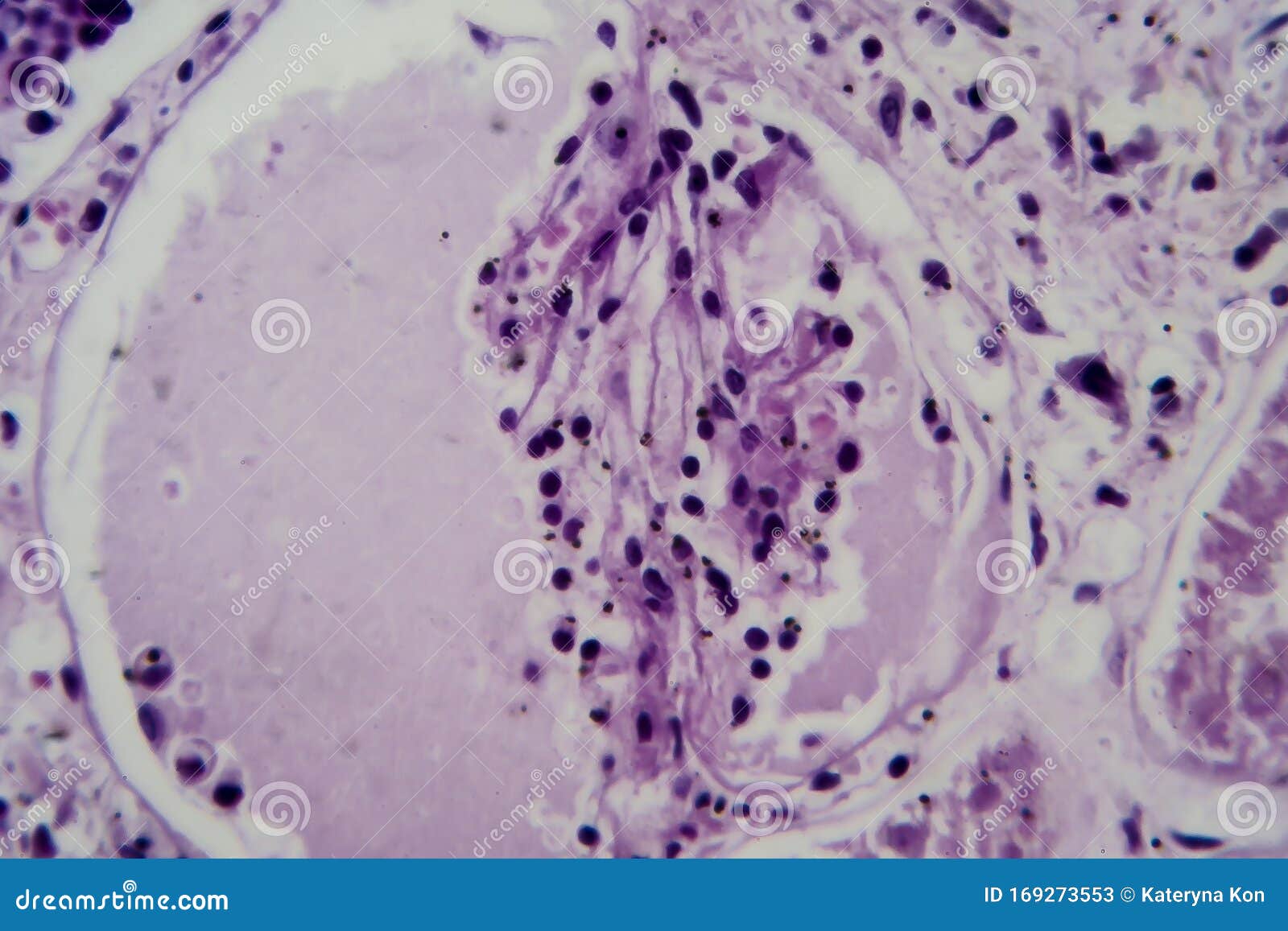 Acute Glomerulonephritis, Light Micrograph Stock Image - Image of ...