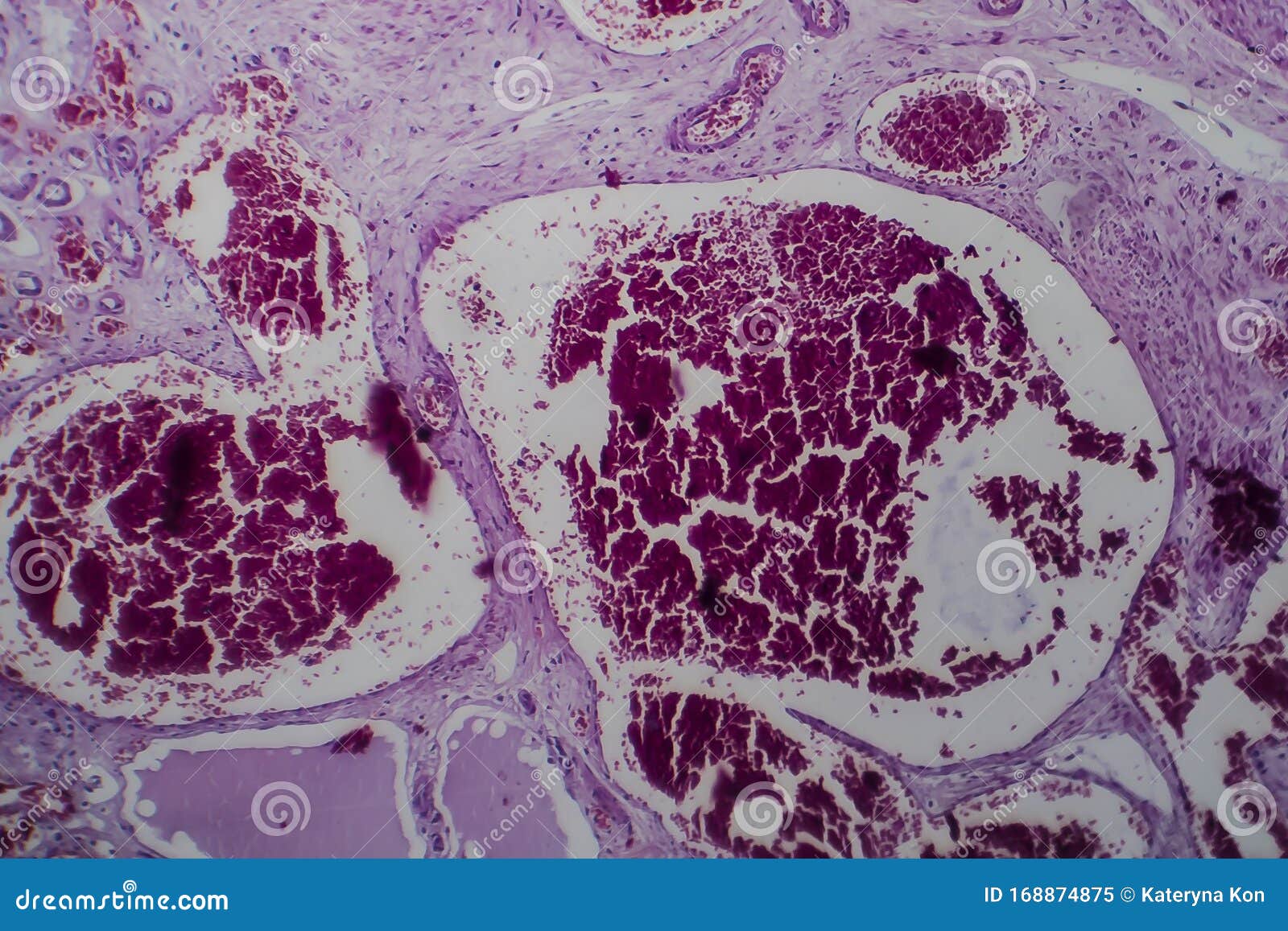 Acute Glomerulonephritis, Light Micrograph Stock Image - Image of ...