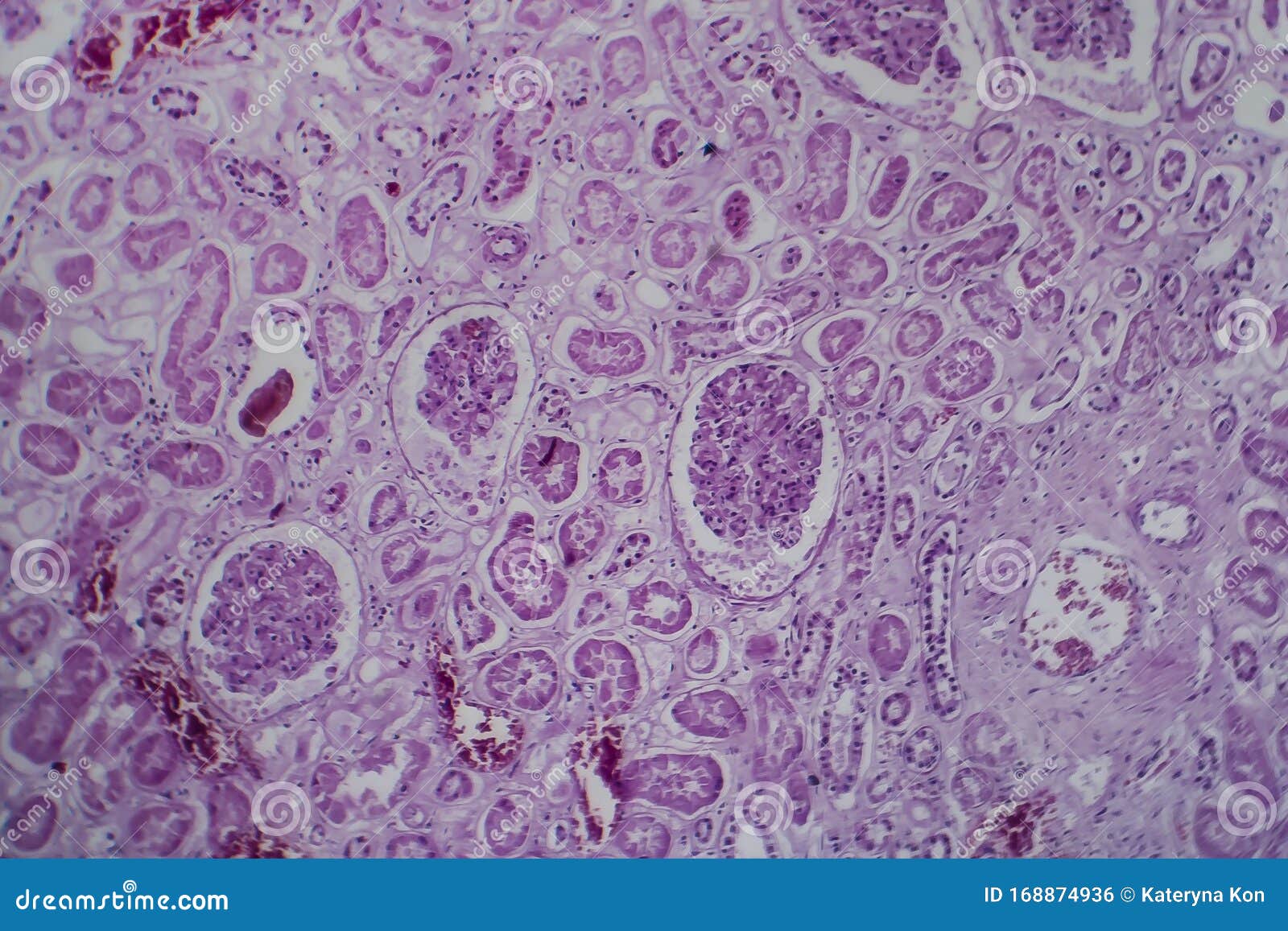 Acute Glomerulonephritis, Light Micrograph Stock Photo - Image of ...
