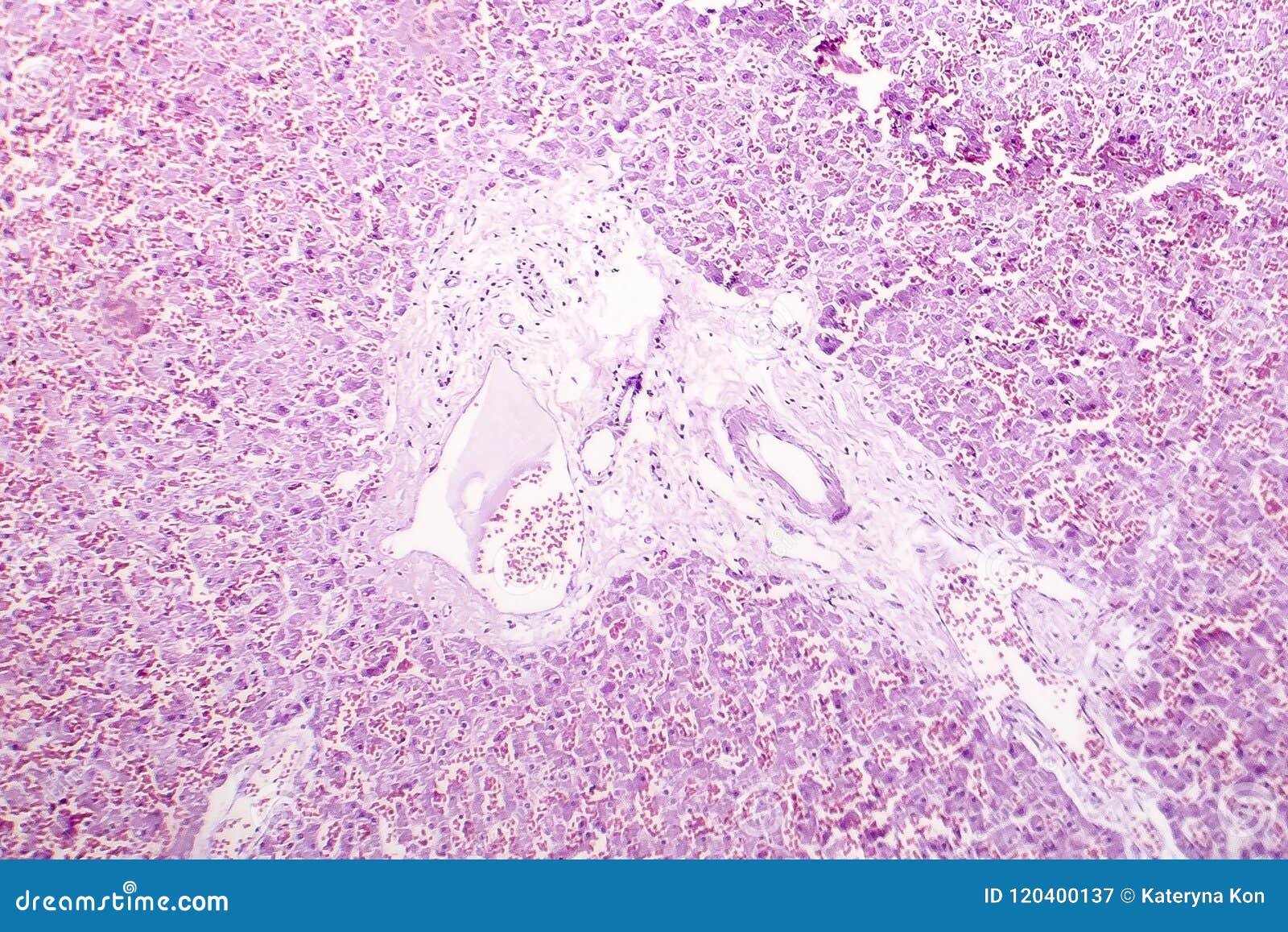 Acute Hepatic Congestion, Light Micrograph Stock Image - Image of ...