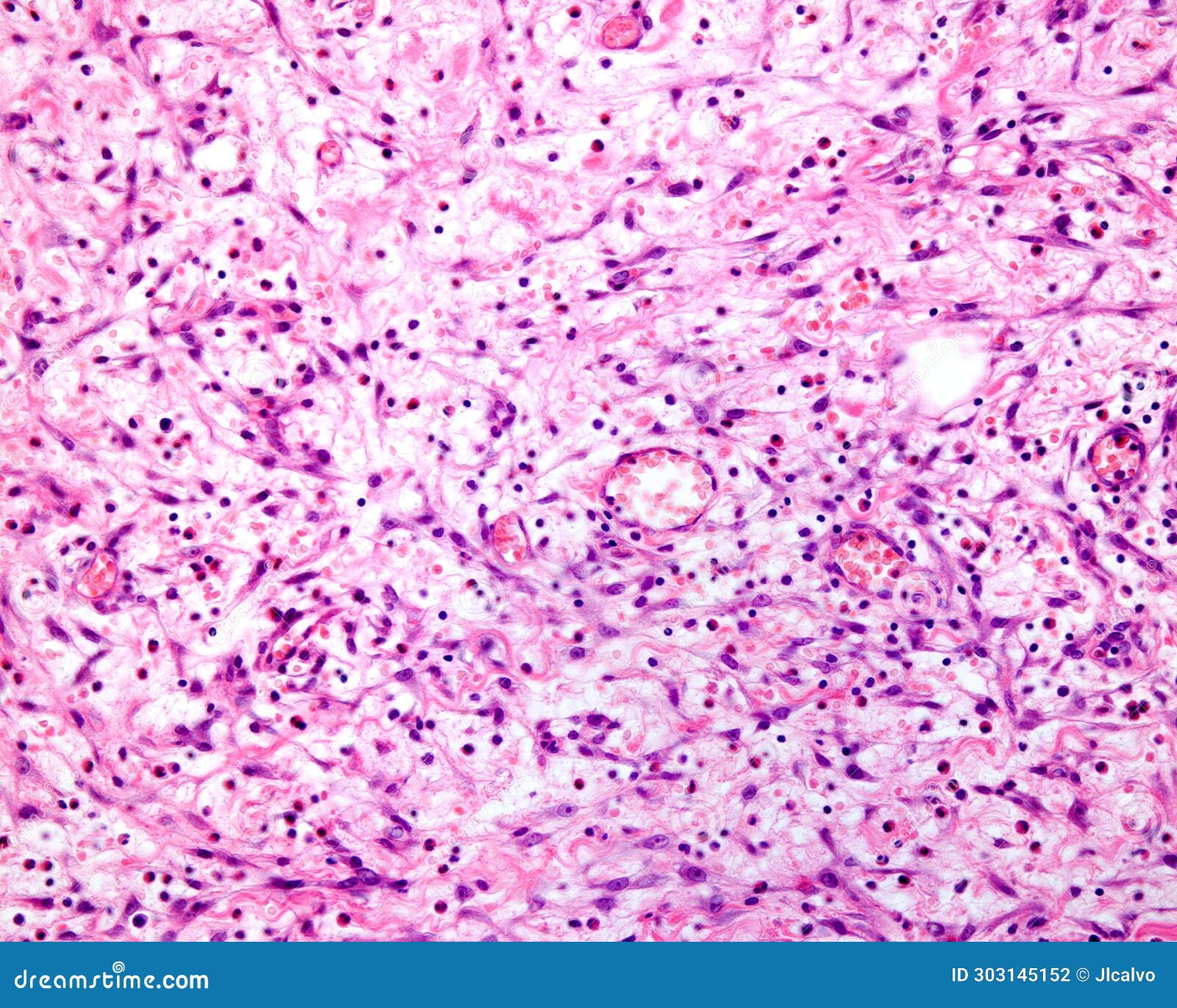 Acute inflammation stock photo. Image of inflammation - 303145152