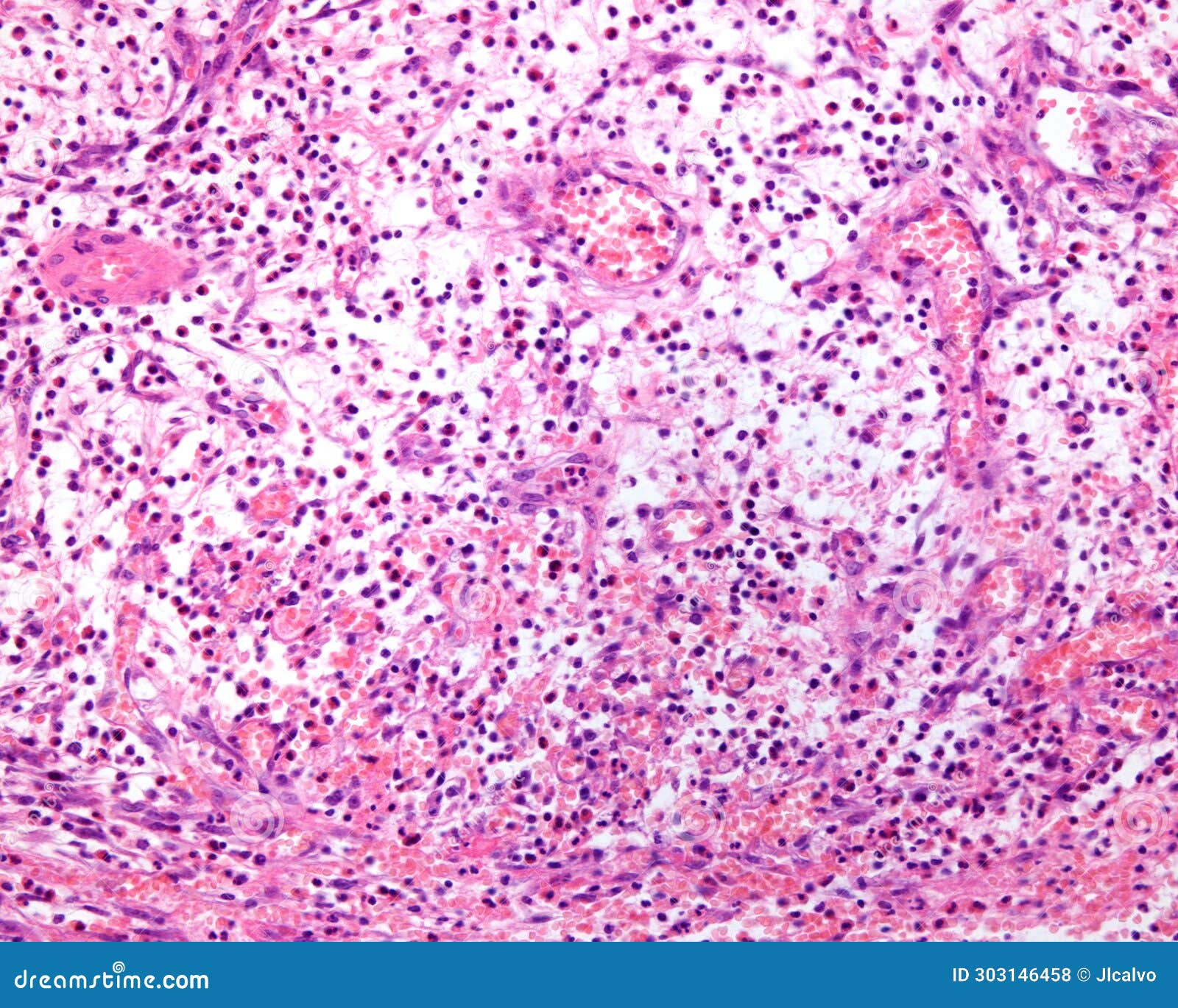 Acute inflammation stock photo. Image of micrograph - 303146458