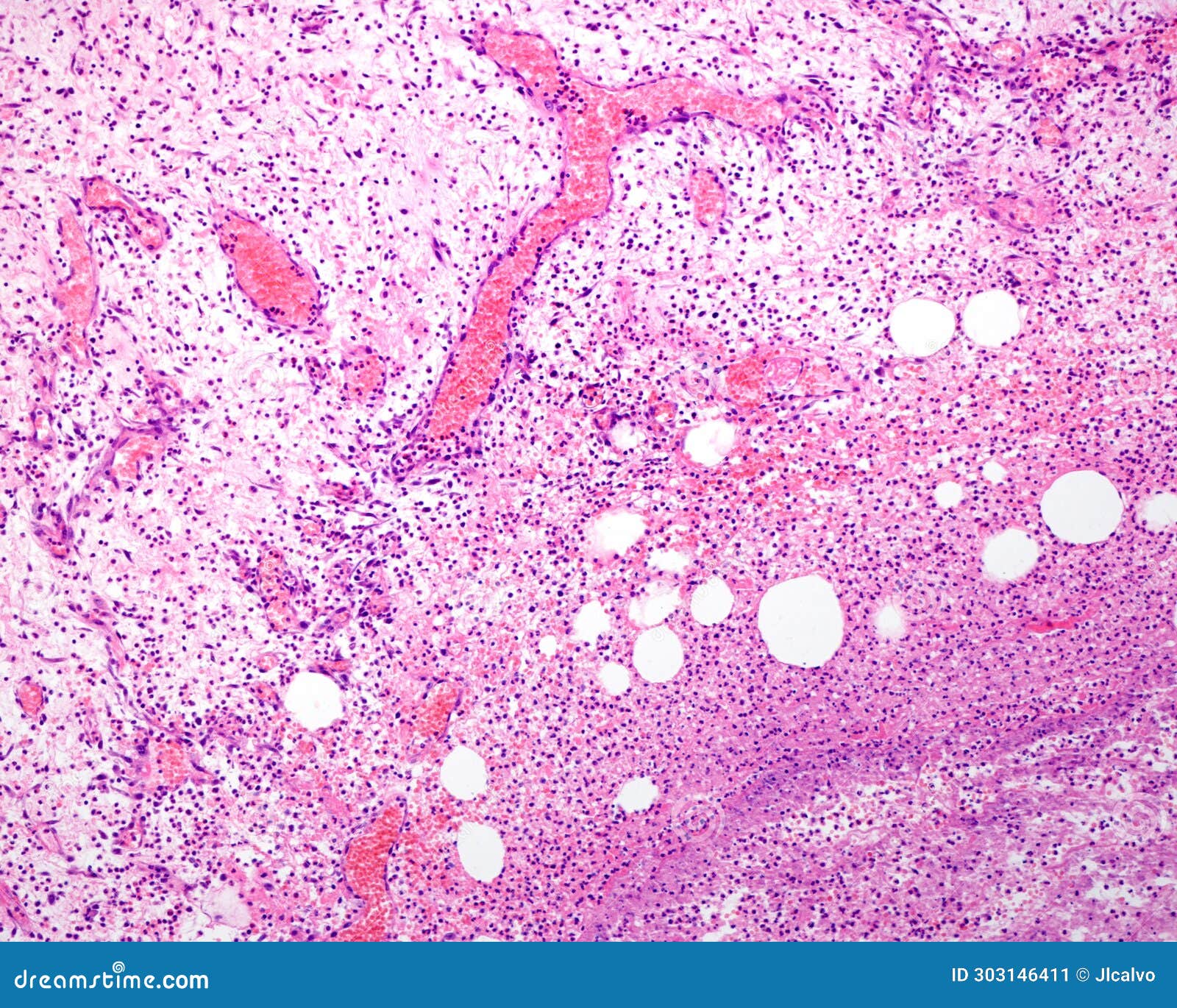 Acute inflammation stock image. Image of microscopic - 303146411