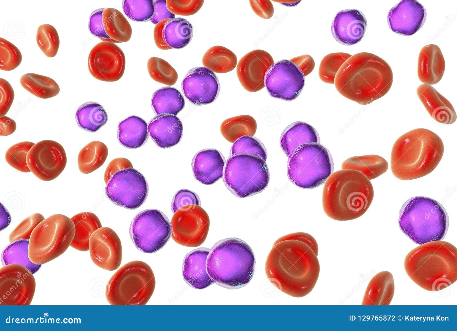 Acute Lymphoblastic Leukemia Stock Illustration - Illustration of ...