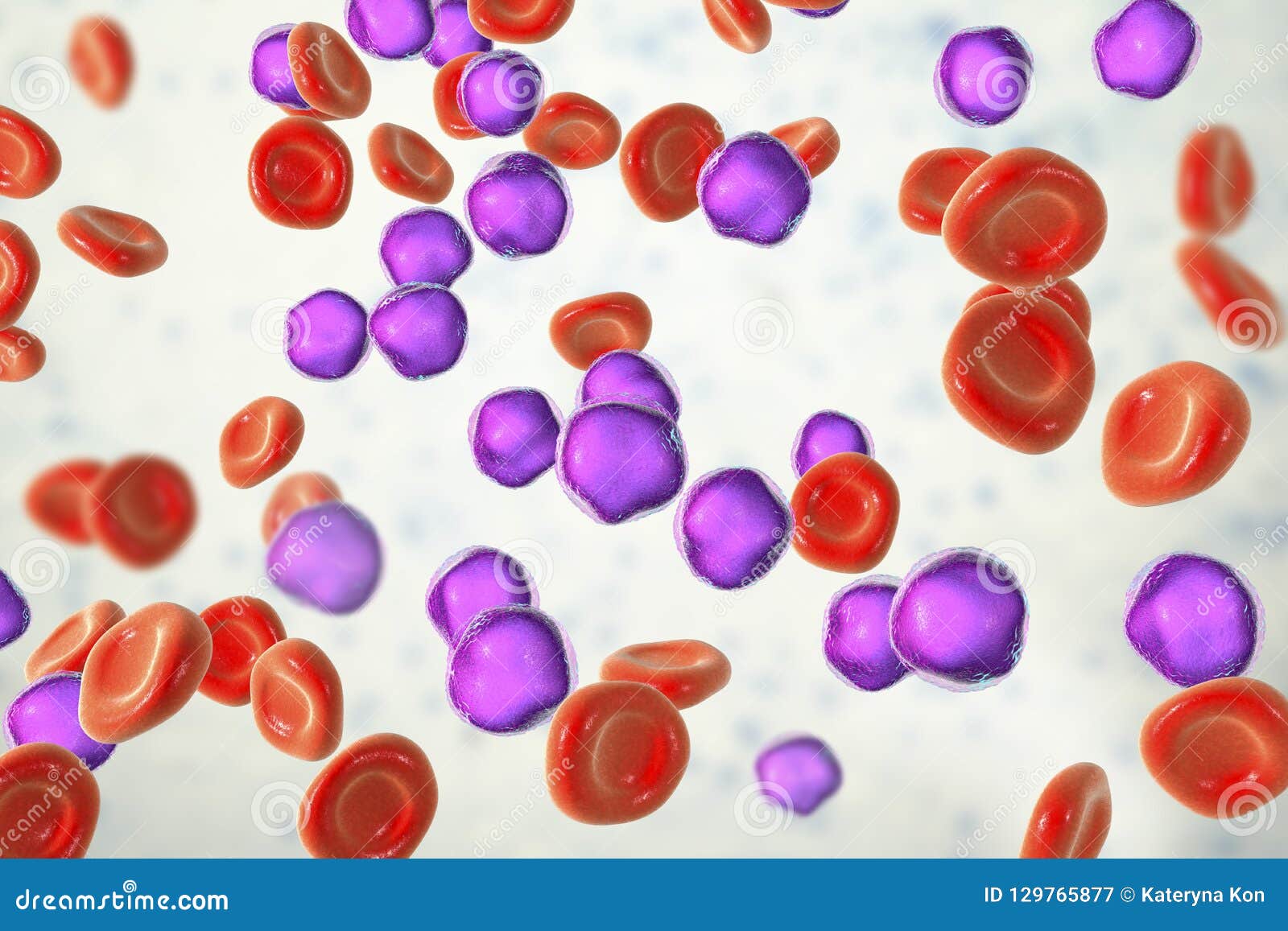 Acute Lymphoblastic Leukemia Stock Illustration - Illustration of ...