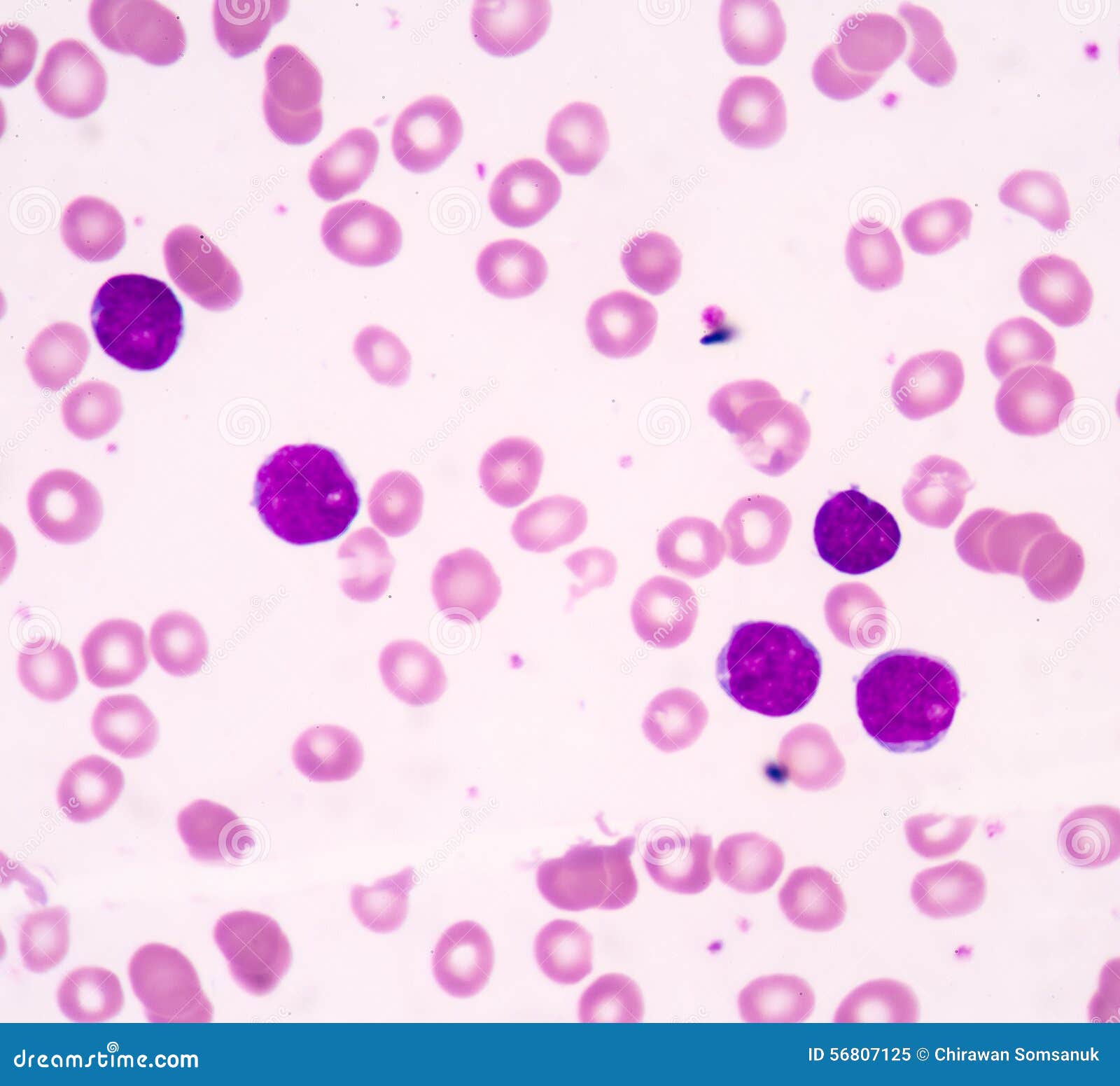 Acute Lymphoblastic Leukemia(ALL) Stock Image - Image of granulation ...