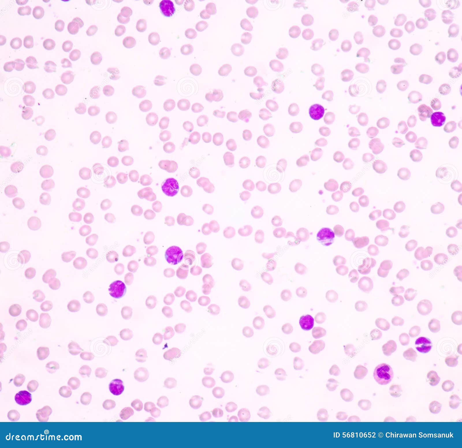 Acute Lymphoblastic Leukemia(ALL) Stock Photo - Image of granulated ...