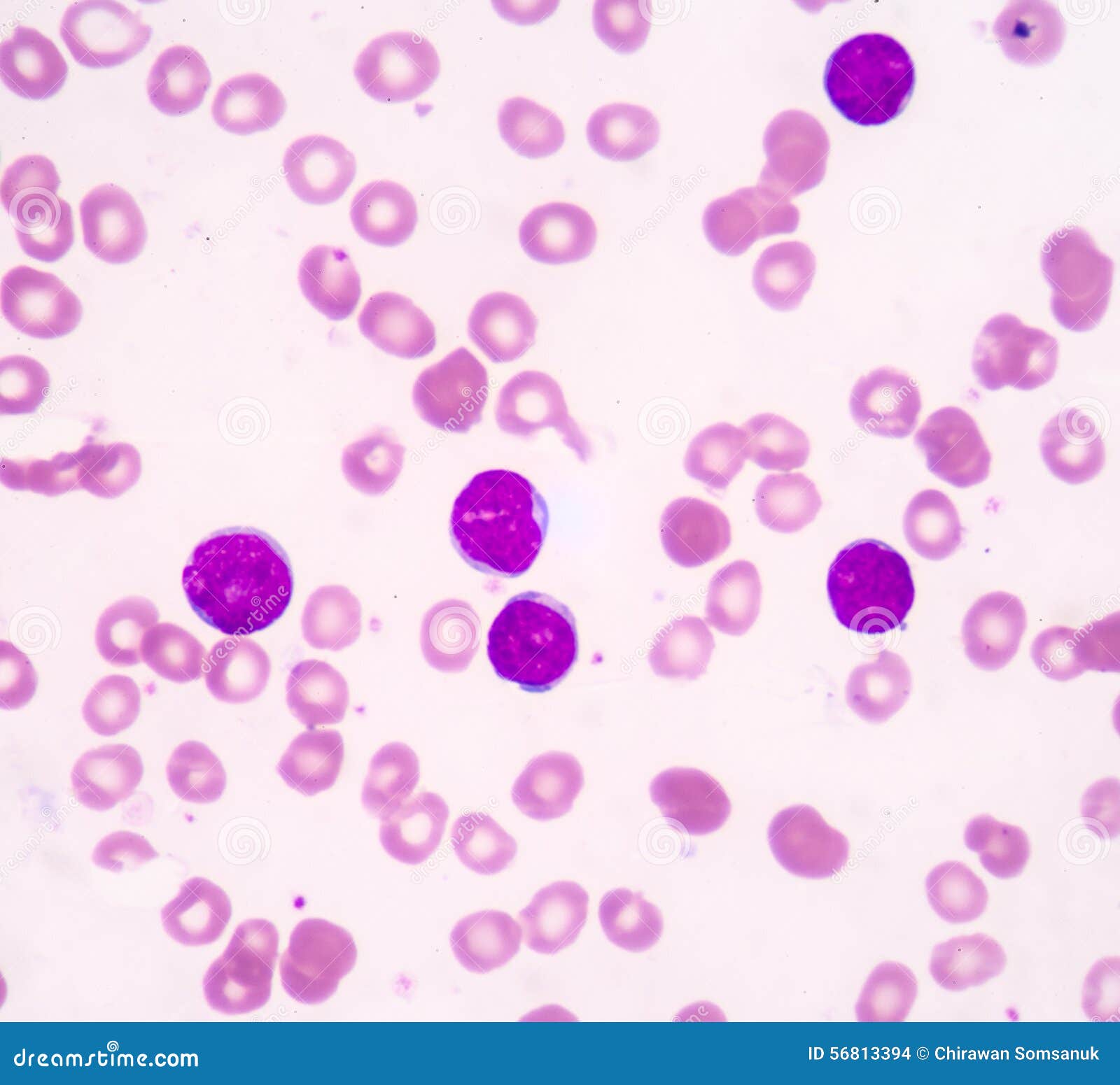 Leukemia Under Microscope