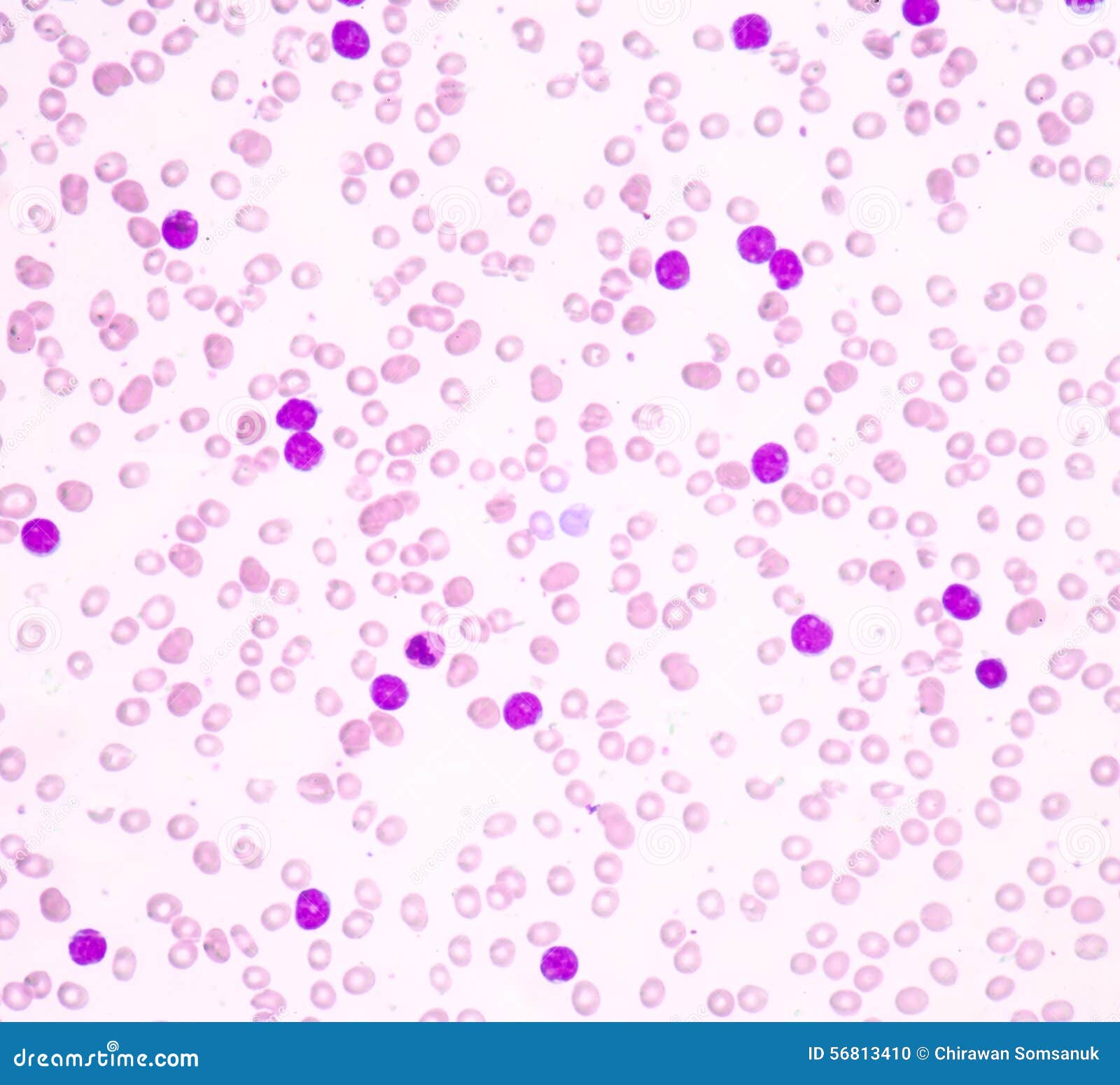 Acute Lymphoblastic Leukemia(ALL) Stock Photo - Image of cell, marrow ...