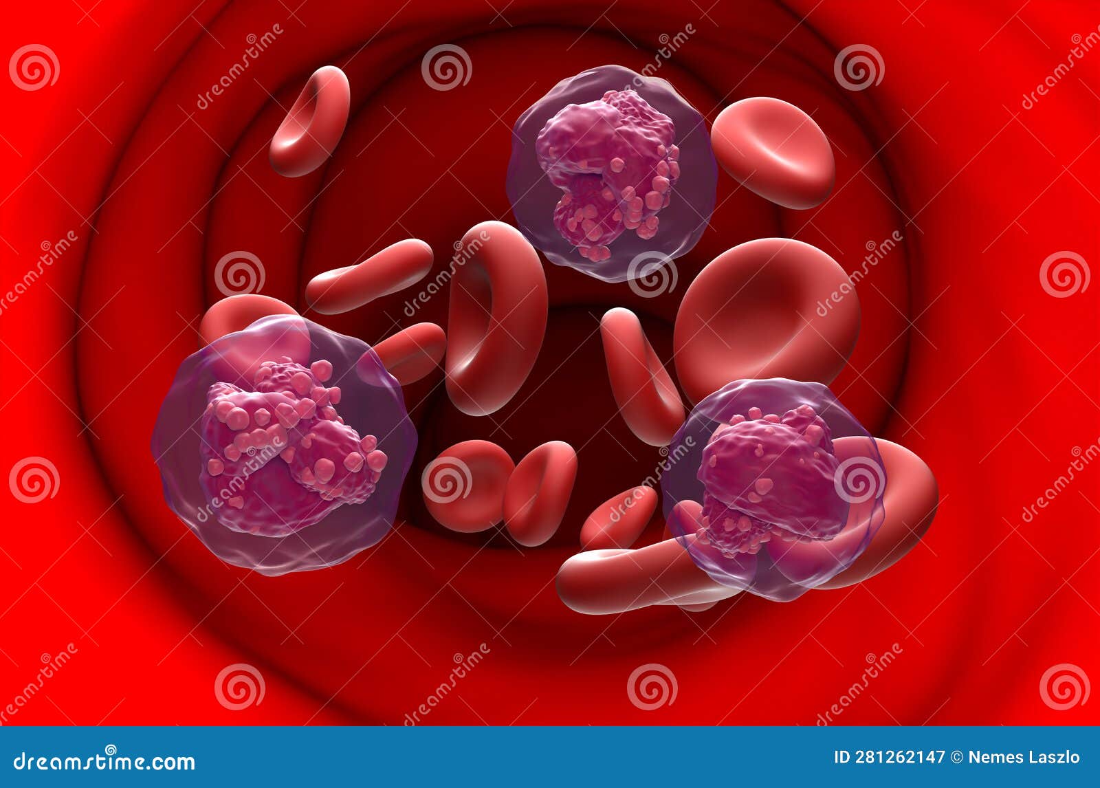 Acute Lymphoblastic Leukemia (ALL) Cancer Cell in Blood Flow - Section ...