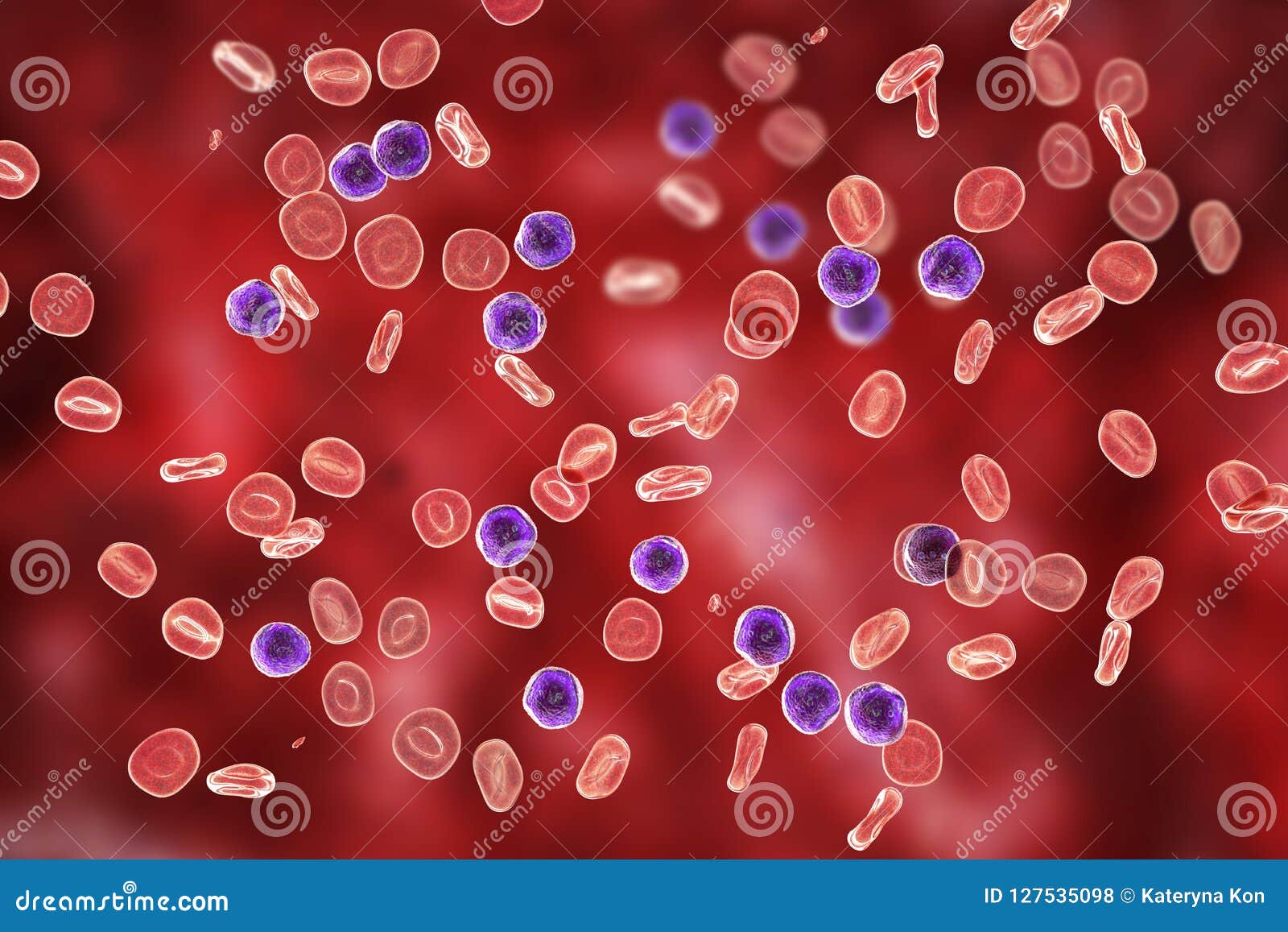 Acute Lymphoblastic Leukemia Stock Illustration - Illustration of ...