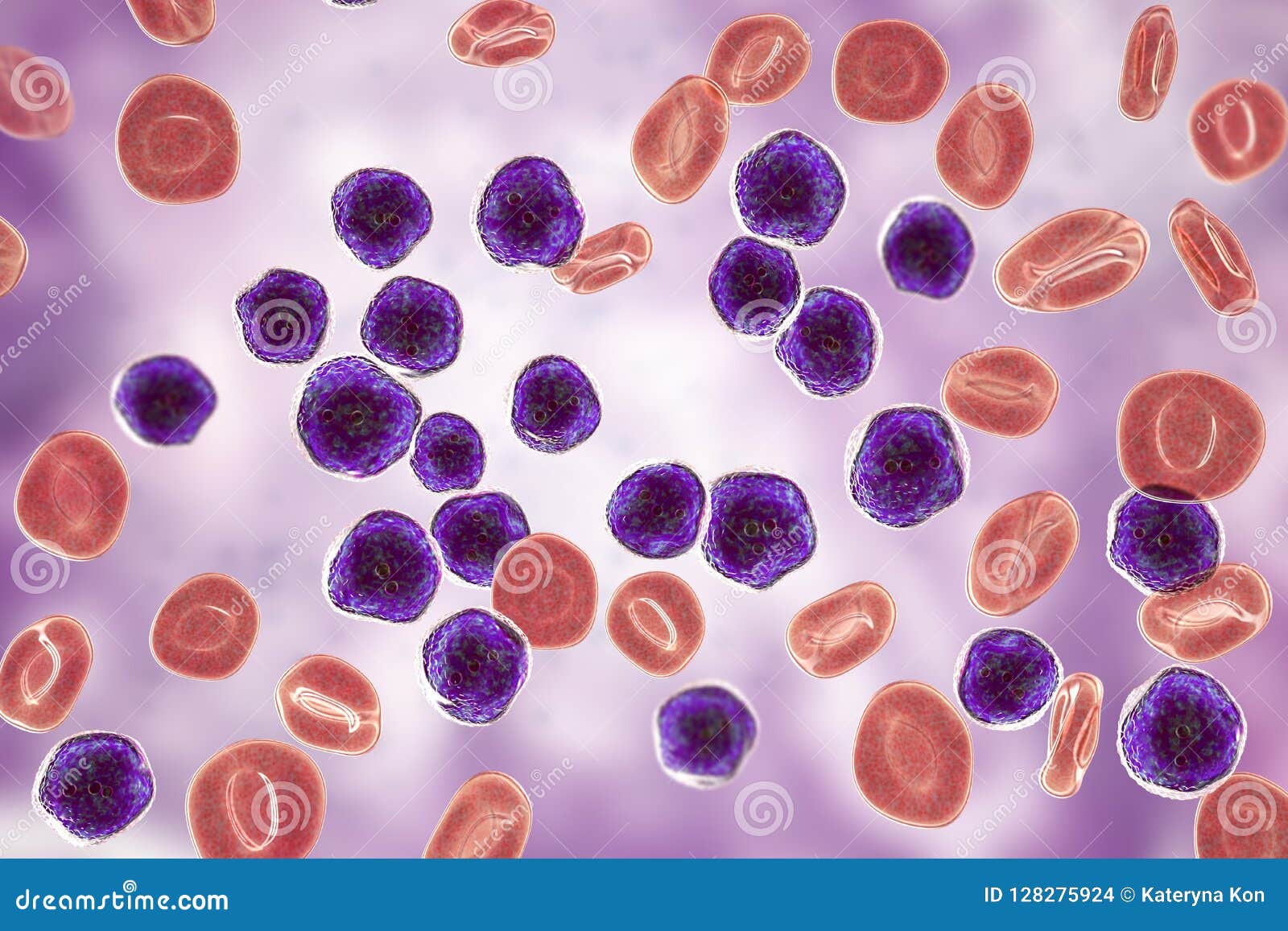 Acute Lymphoblastic Leukemia, Bone Marrow Smear Stock Illustration ...