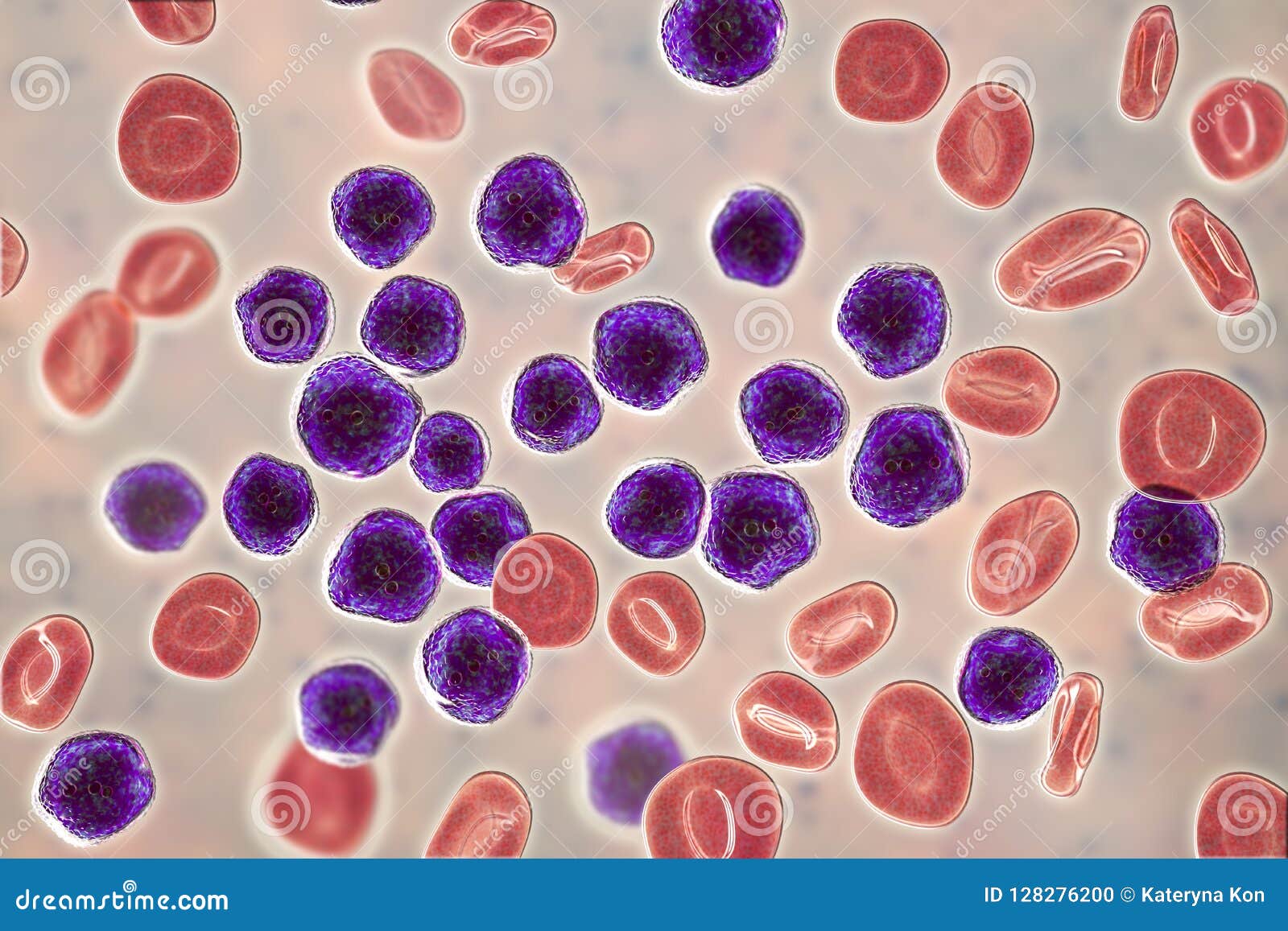 Acute Lymphoblastic Leukemia, Bone Marrow Smear Stock Illustration ...