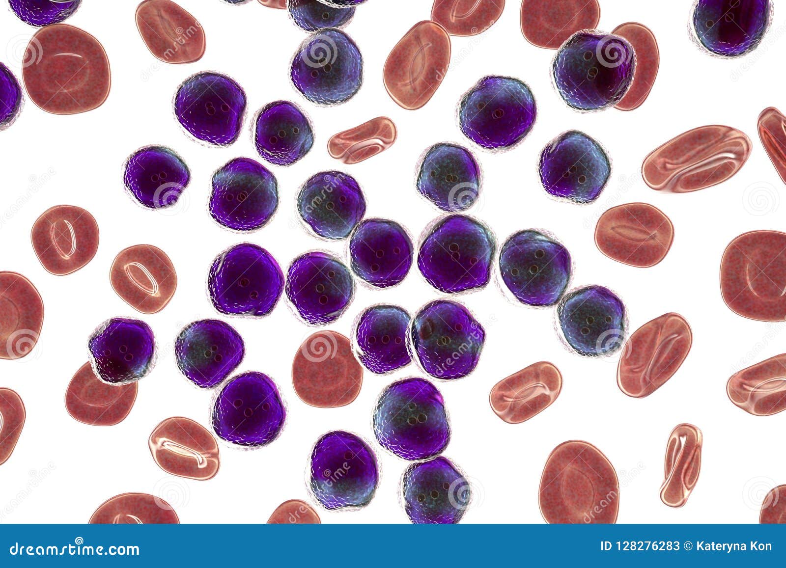 Acute Lymphoblastic Leukemia, Bone Marrow Smear Stock Illustration ...