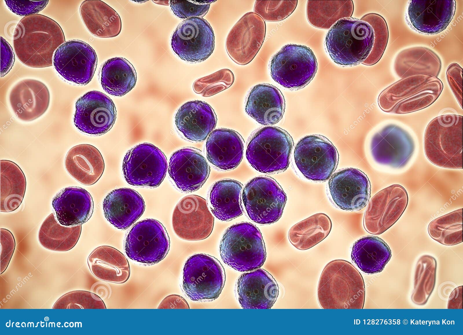 Acute Lymphoblastic Leukemia, Bone Marrow Smear Stock Illustration ...