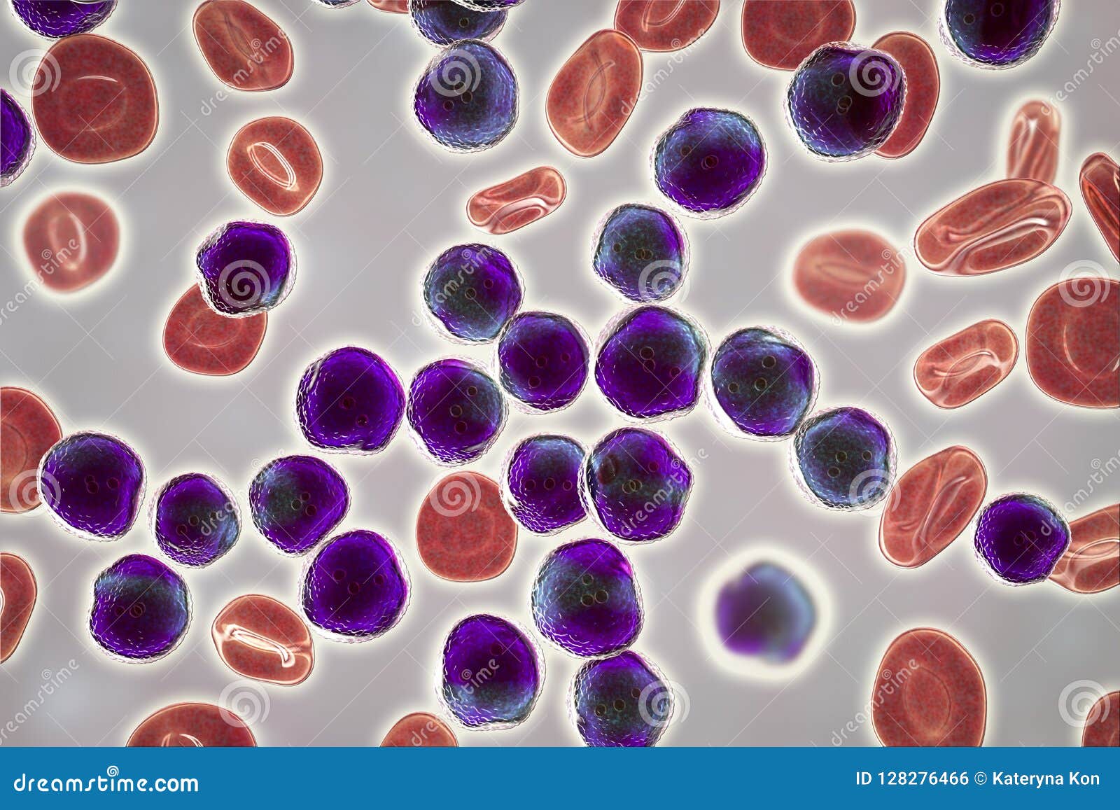 Acute Lymphoblastic Leukemia, Bone Marrow Smear Stock Illustration ...