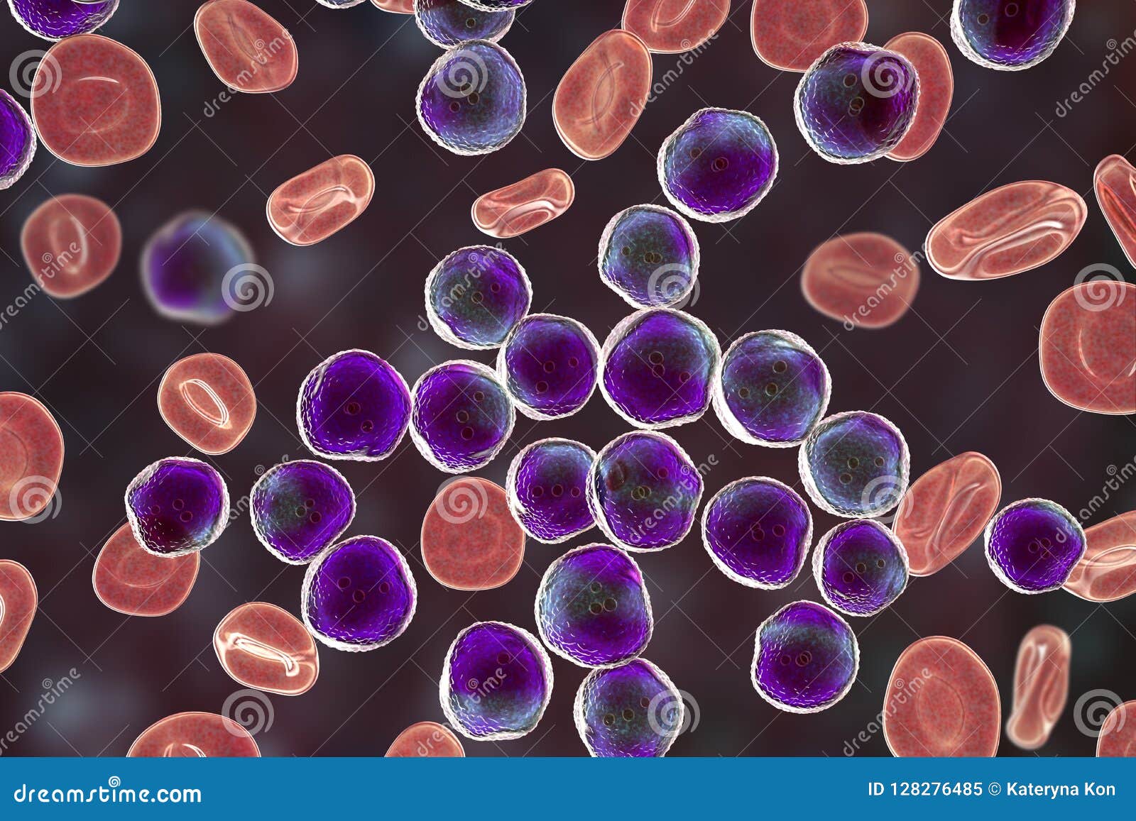 Acute Lymphoblastic Leukemia, Bone Marrow Smear Stock Illustration ...