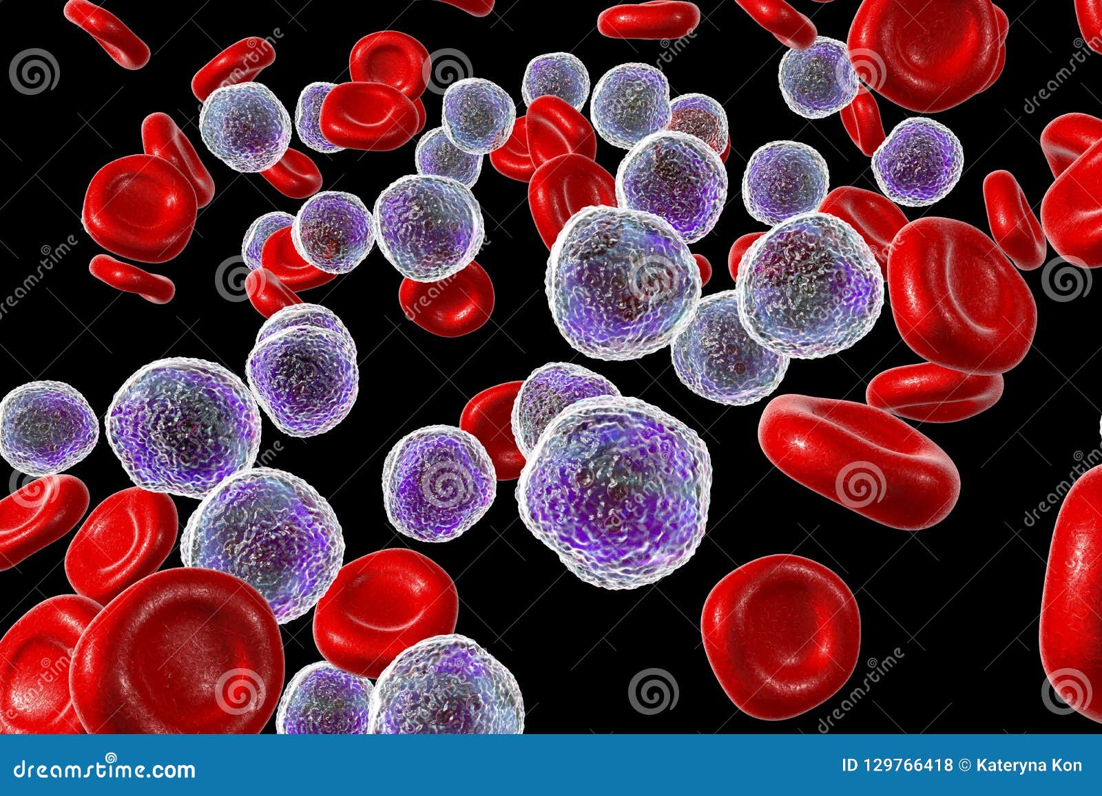 Acute Lymphoblastic Leukemia Stock Illustration - Illustration of blood ...