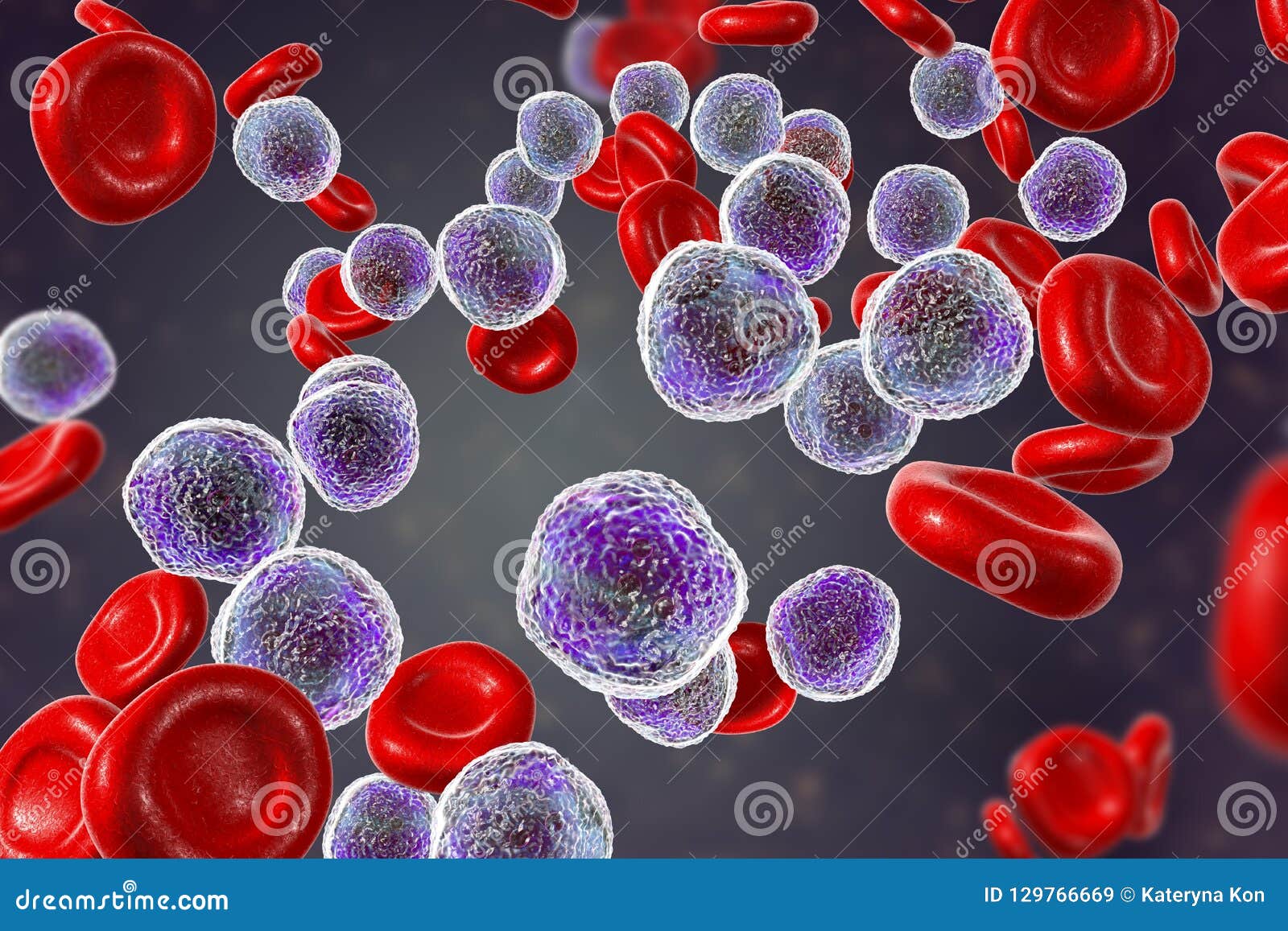 Acute Lymphoblastic Leukemia Stock Illustration - Illustration of ...