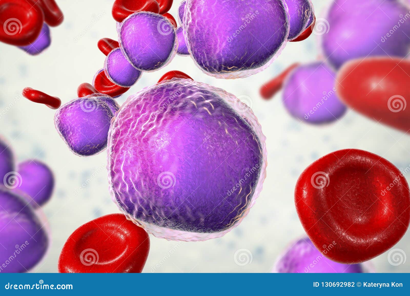 Acute Lymphoblastic Leukemia Stock Illustration - Illustration of ...