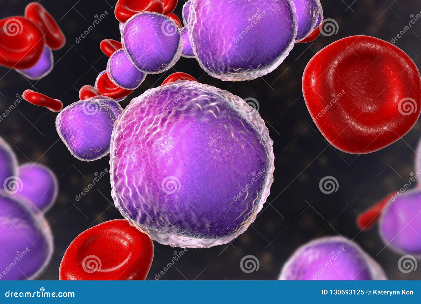 Acute Lymphoblastic Leukemia Stock Illustration - Illustration of ...