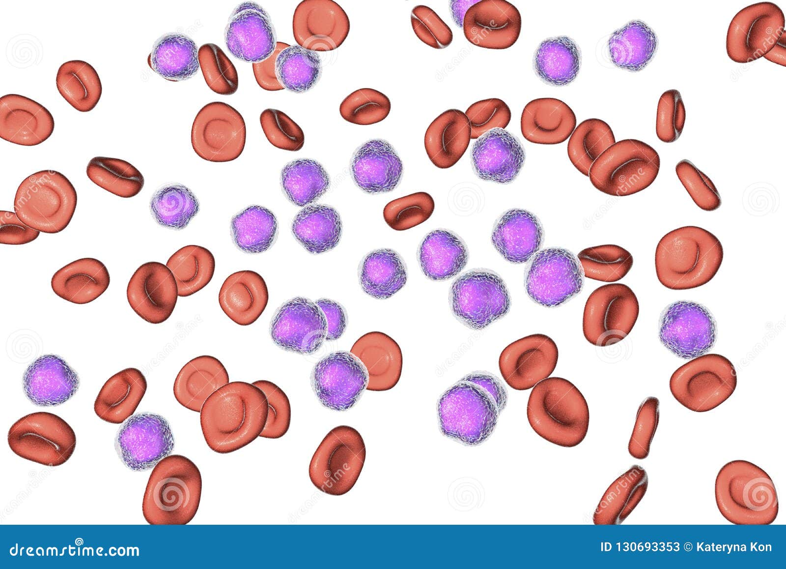Acute Lymphoblastic Leukemia Stock Illustration - Illustration of human ...